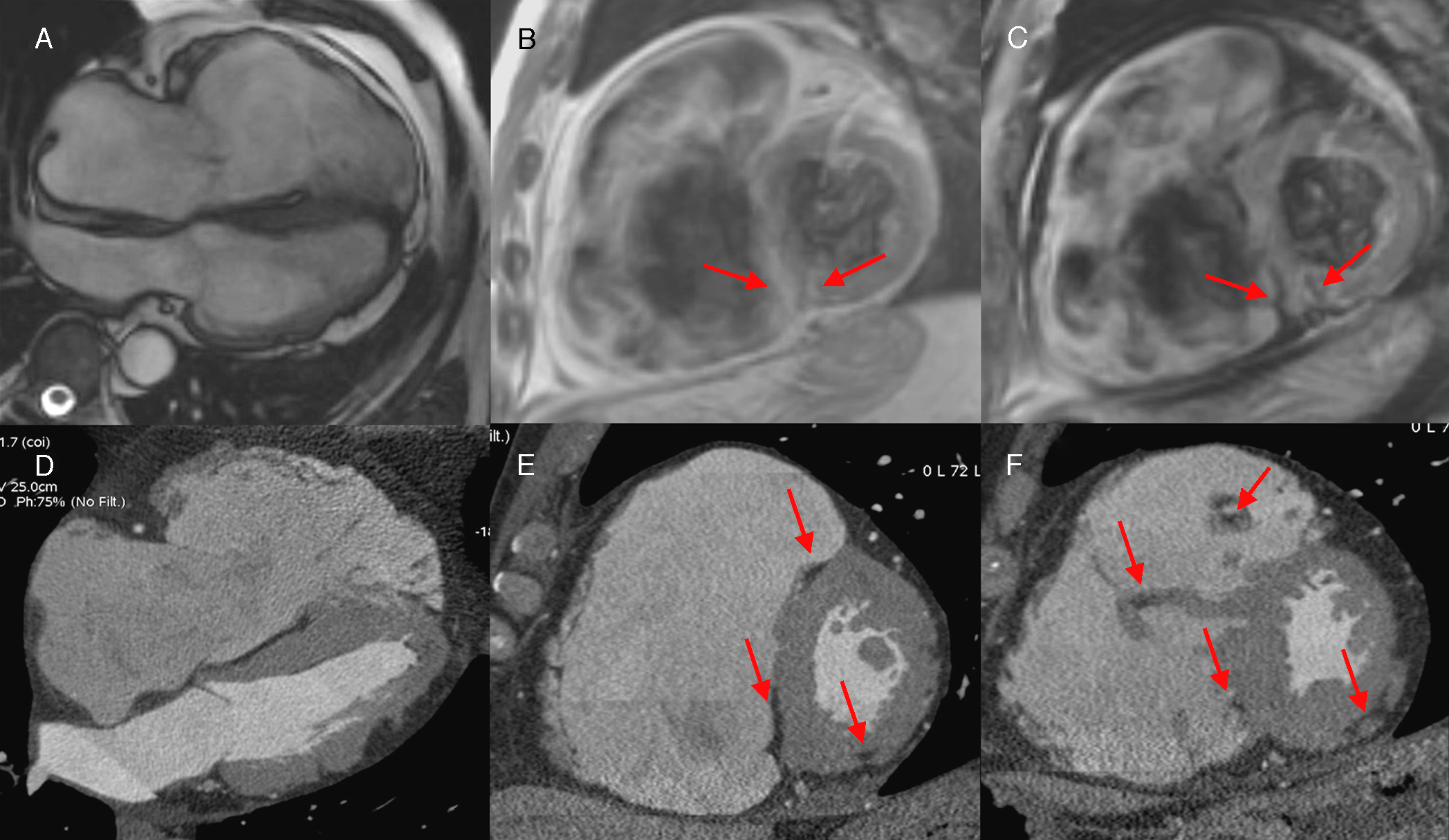 Infiltración grasa: resonancia o TC multidetector | Revista Española de ...