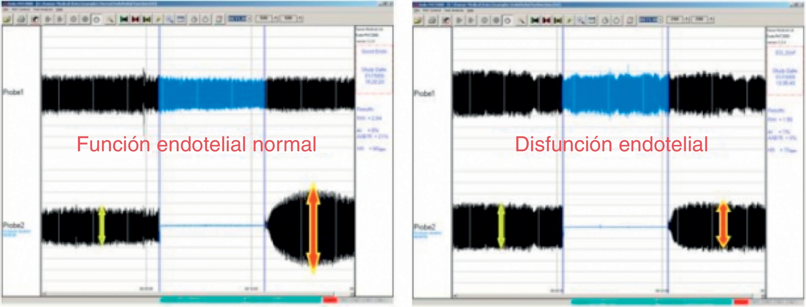 Evaluación no invasiva de la función endotelial en la práctica clínica ...