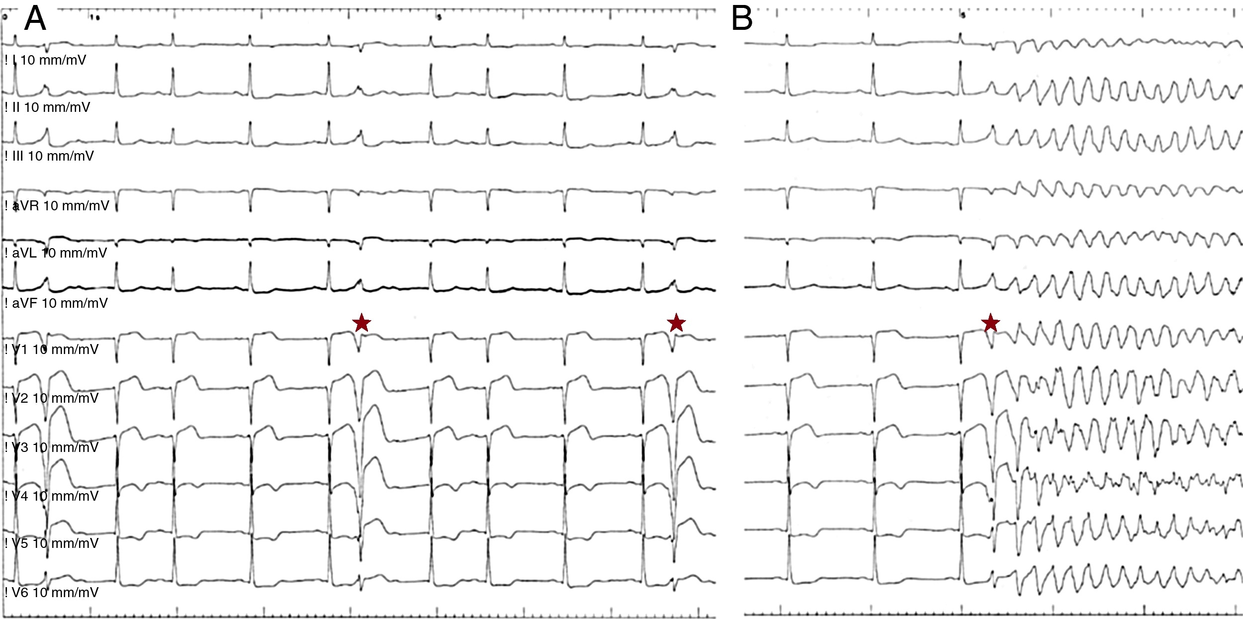 La fibrilación ventricular, una emergencia electrofisiológica | Revista ...