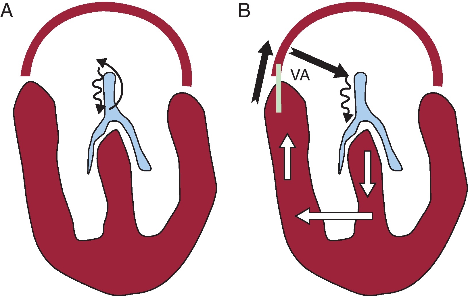 Taquicardias paroxísticas supraventriculares y síndromes de ...