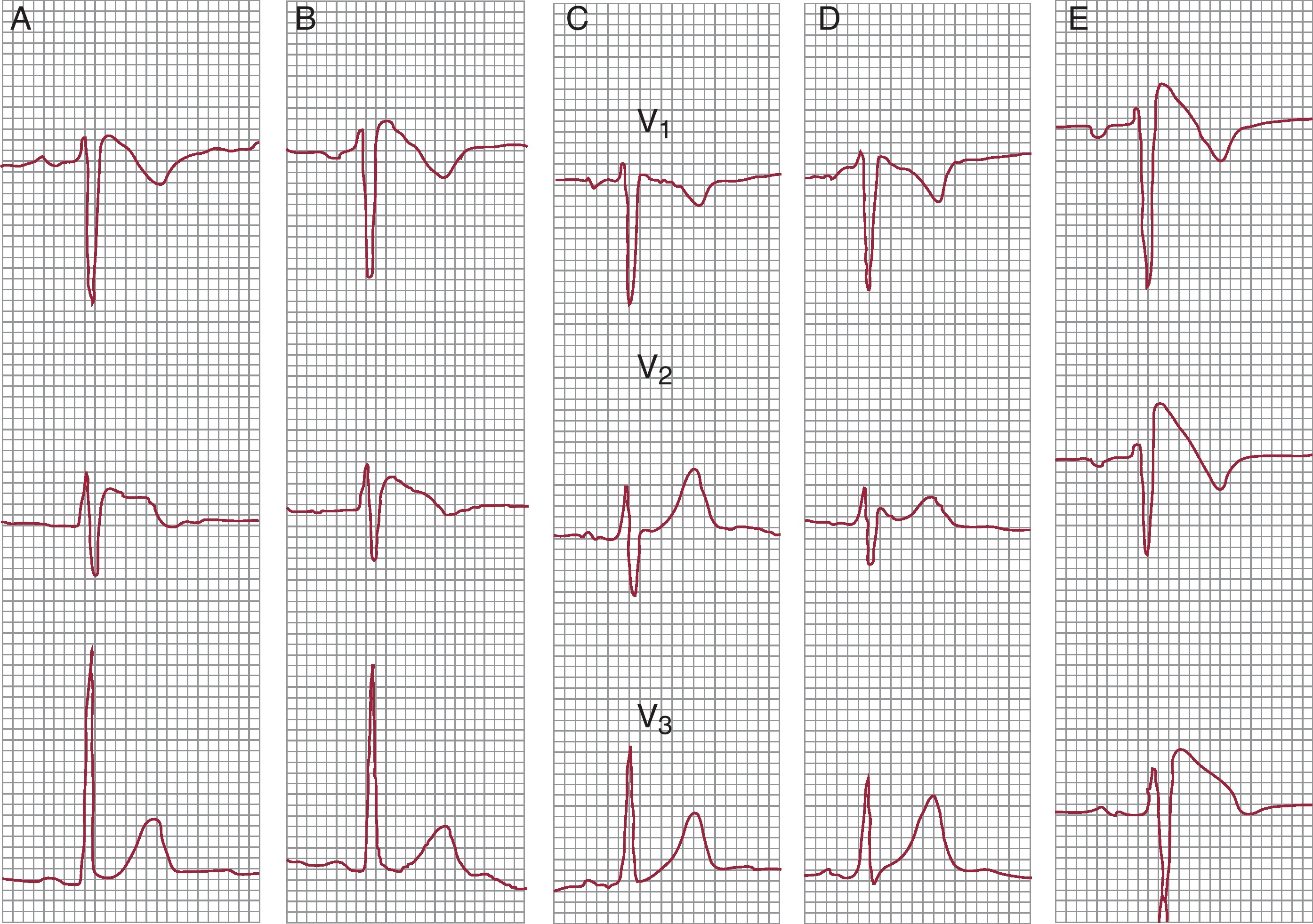 Patrón electrocardiográfico de Brugada inducido por cannabis | Revista ...