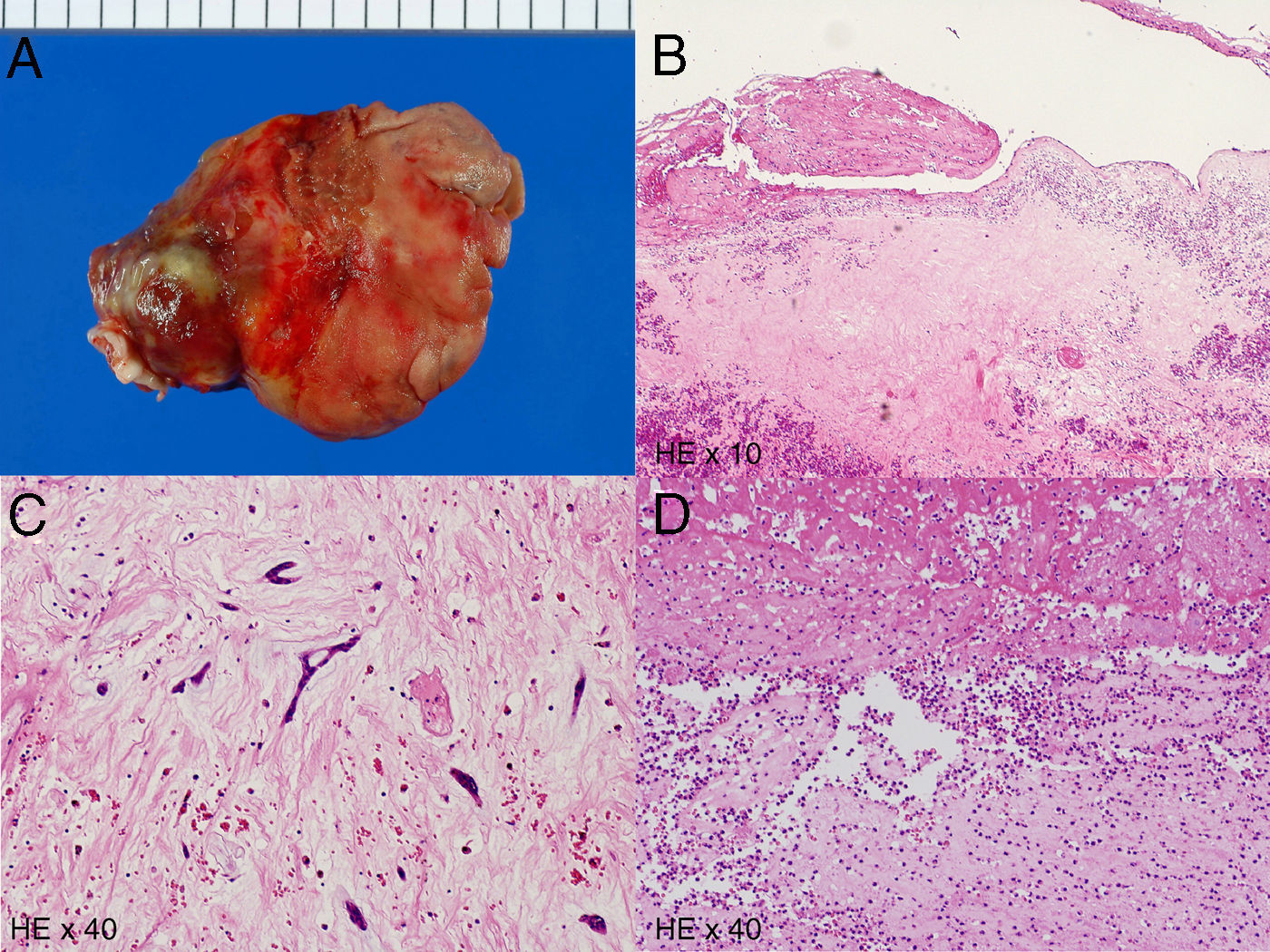 Mixoma auricular infectado de gran tamaño con vegetaciones | Revista ...