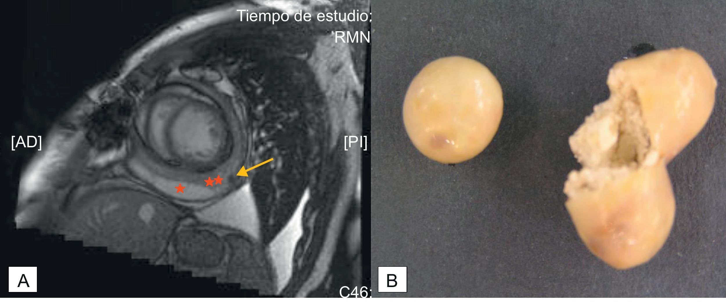 Pericarditis constrictiva por Propionibacterium acnes | Revista ...