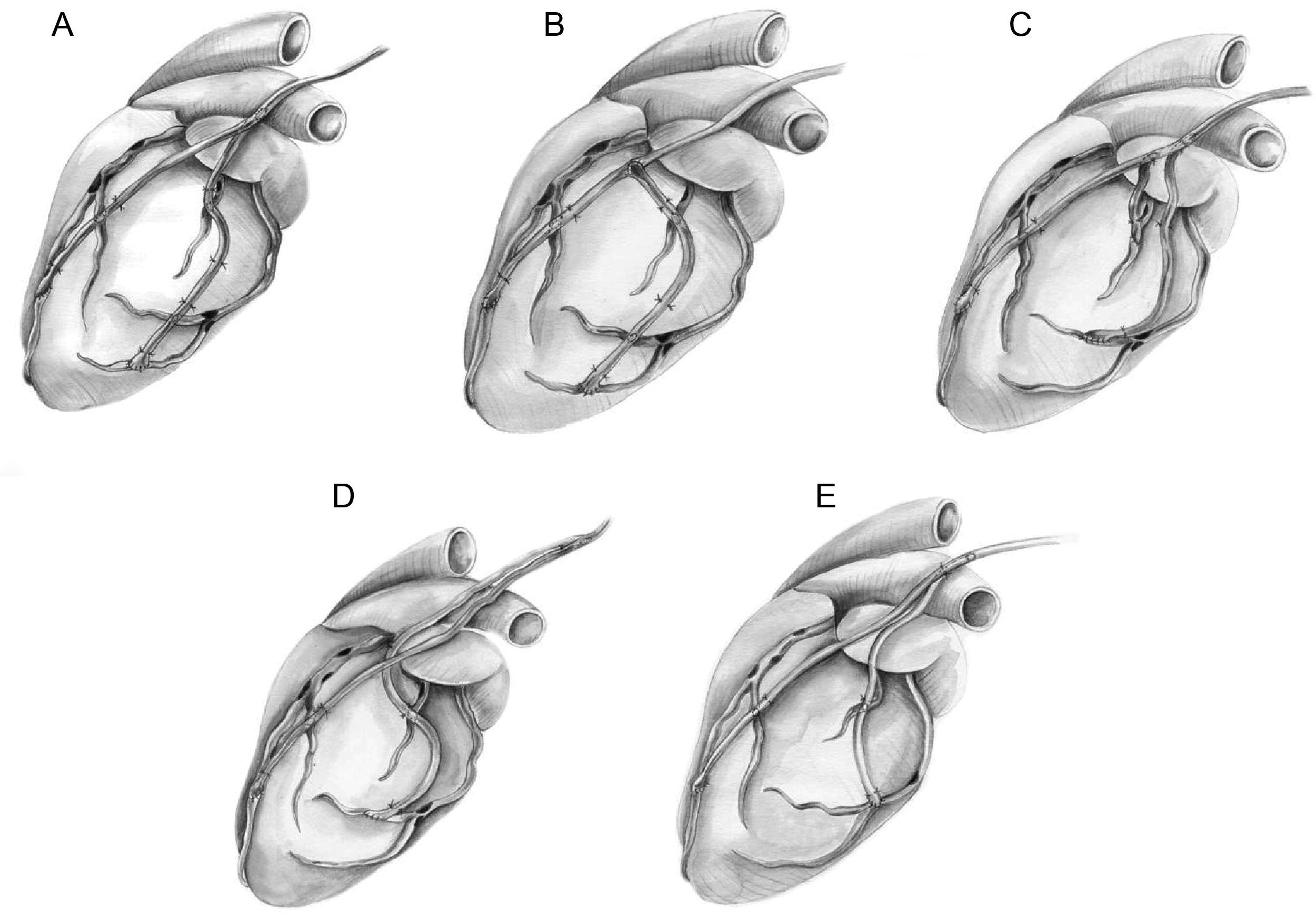 La elección del segundo injerto | Revista Española de Cardiología