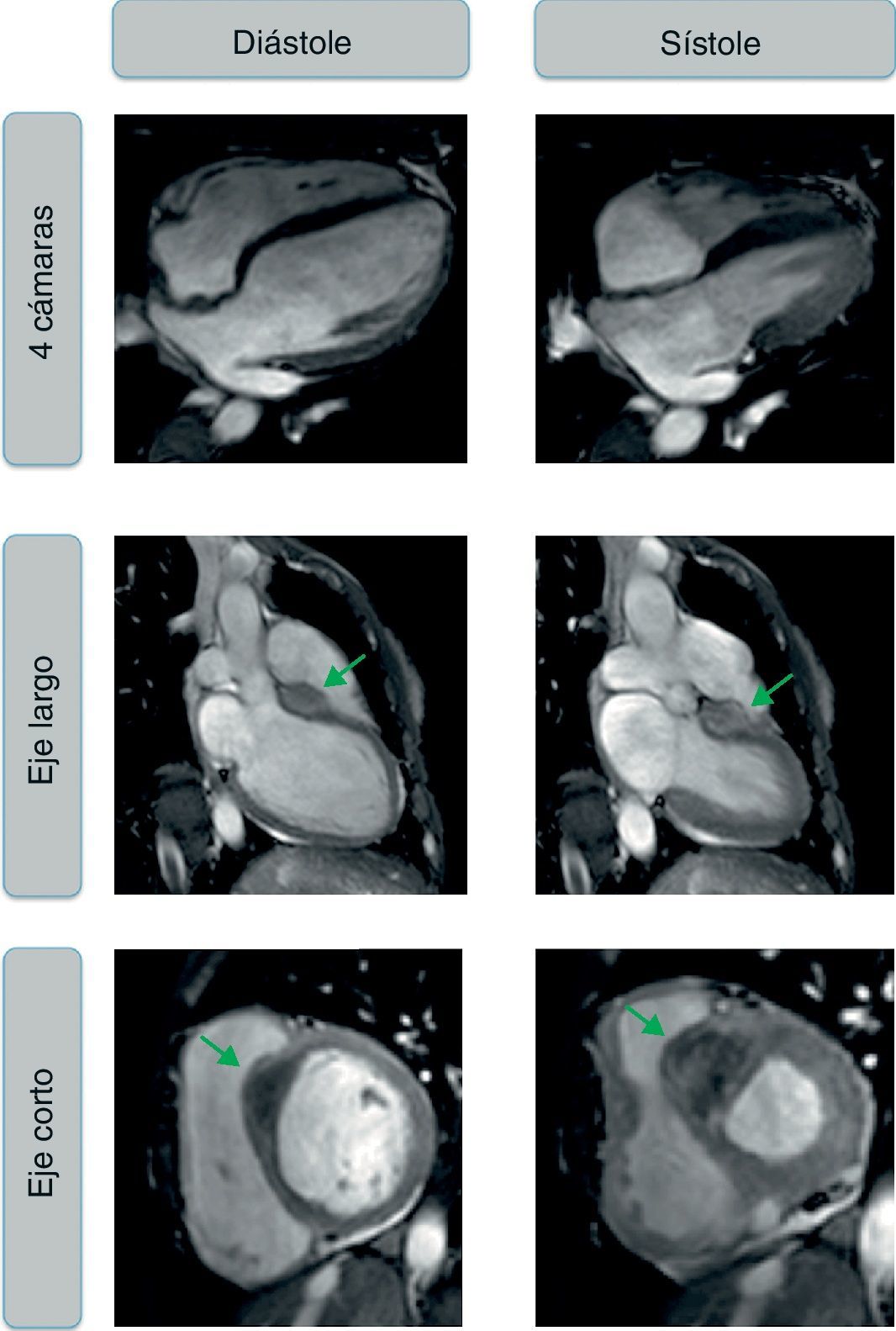 Evaluación detallada de un fibroma miocárdico mediante resonancia ...
