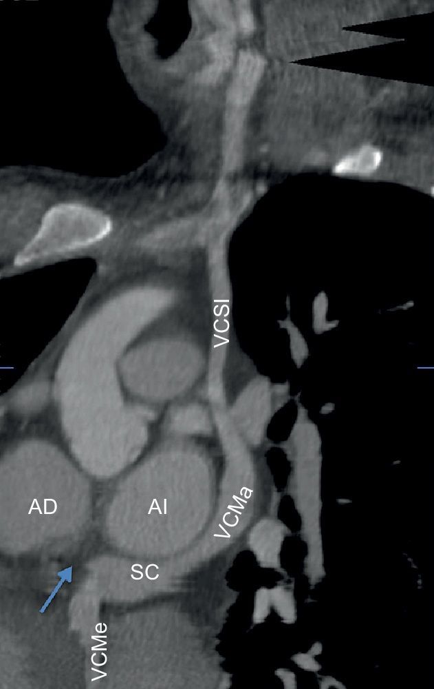 Atresia de orificio del seno coronario con vena cava superior izquierda ...