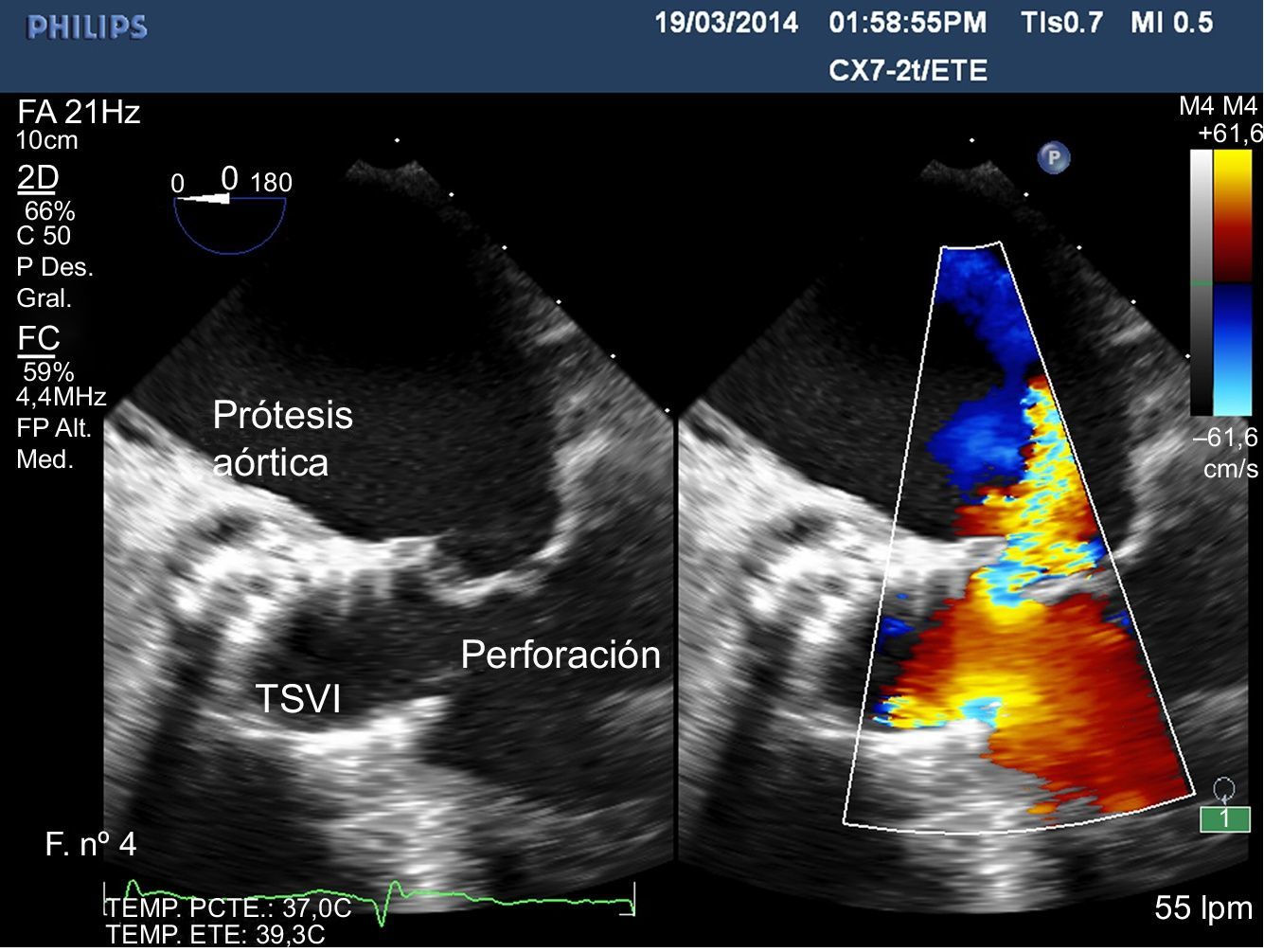 Complicación infrecuente tras implante percutáneo de válvula aórtica ...