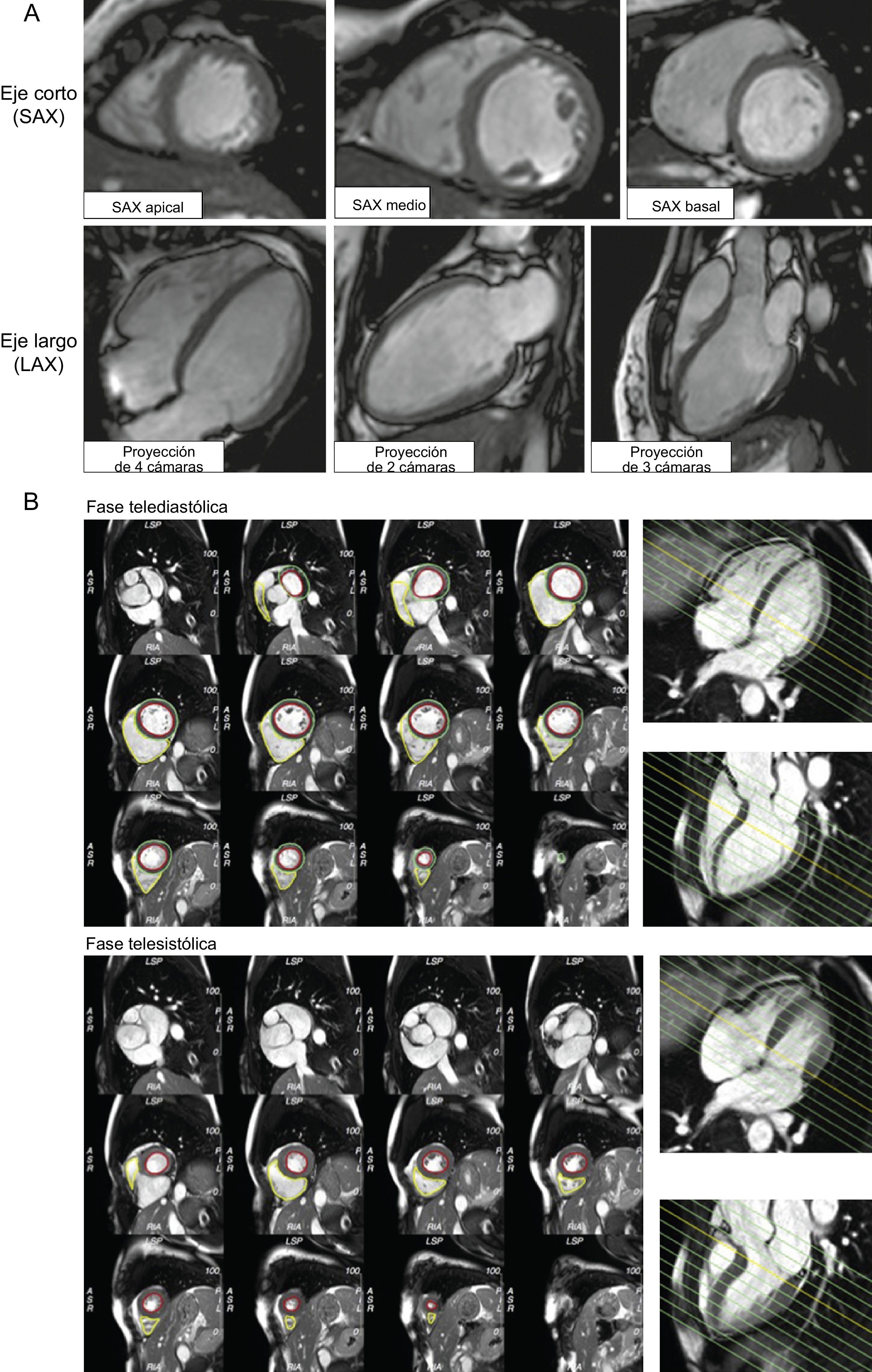 Resonancia magnética cardiovascular en la práctica cardiológica: una ...