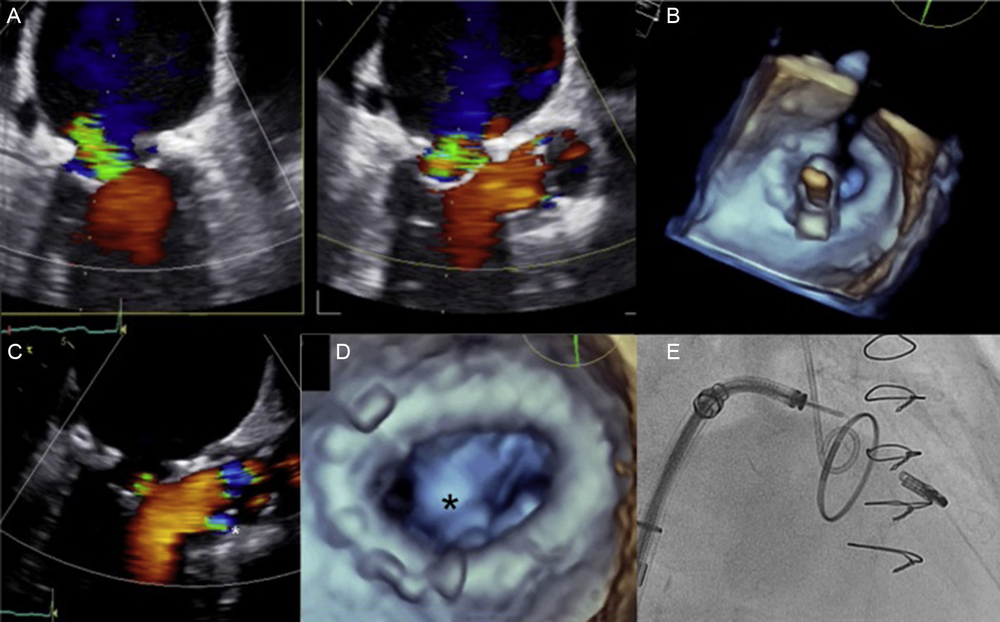 Utilidad de MitraClip® como tratamiento de la insuficiencia mitral ...