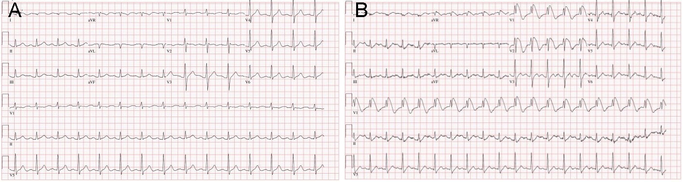 Patrón de Brugada intermitente en relación con cambios en la ...