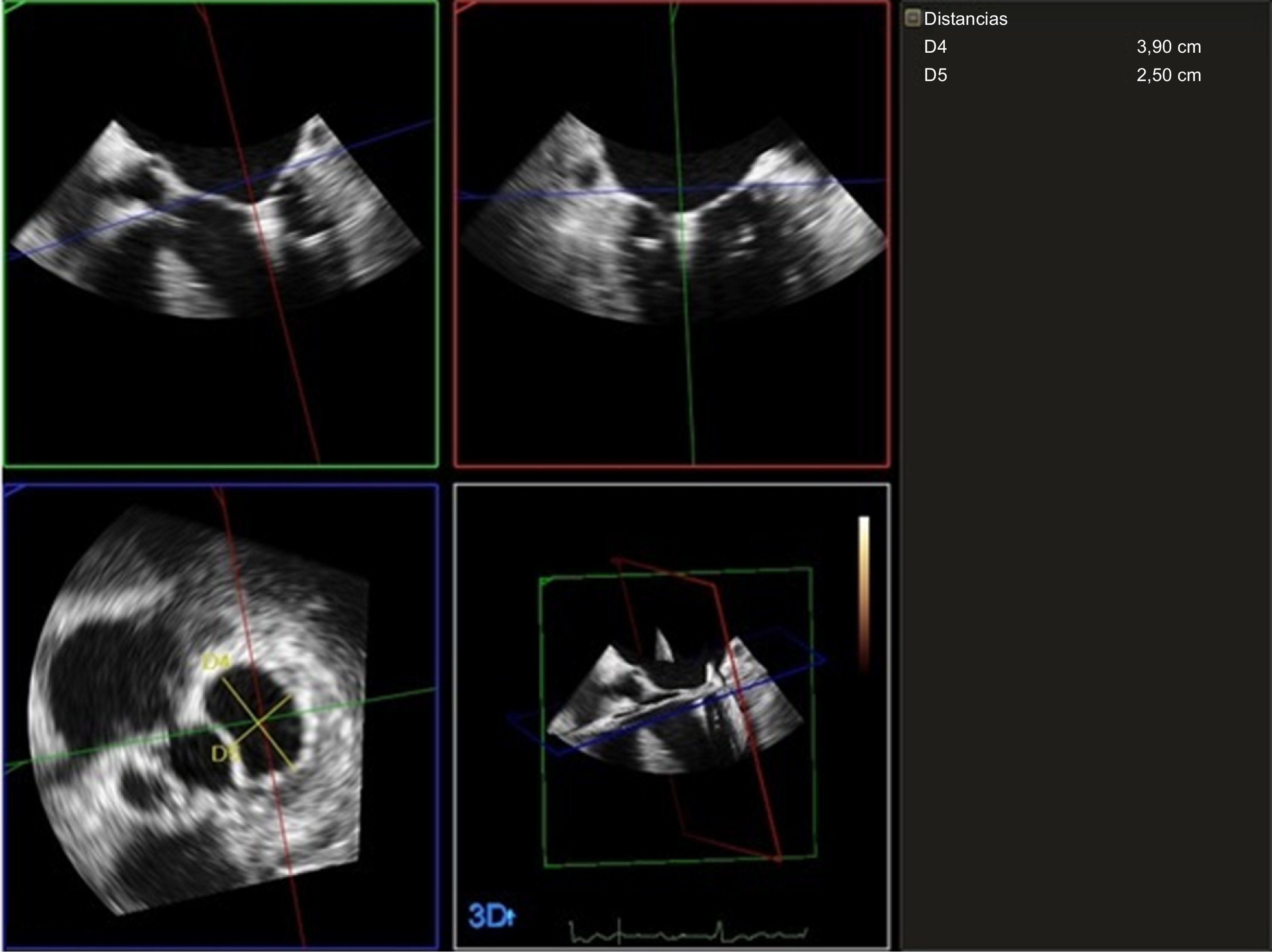 Impacto del remodelado del anillo mitral tras el procedimiento ...