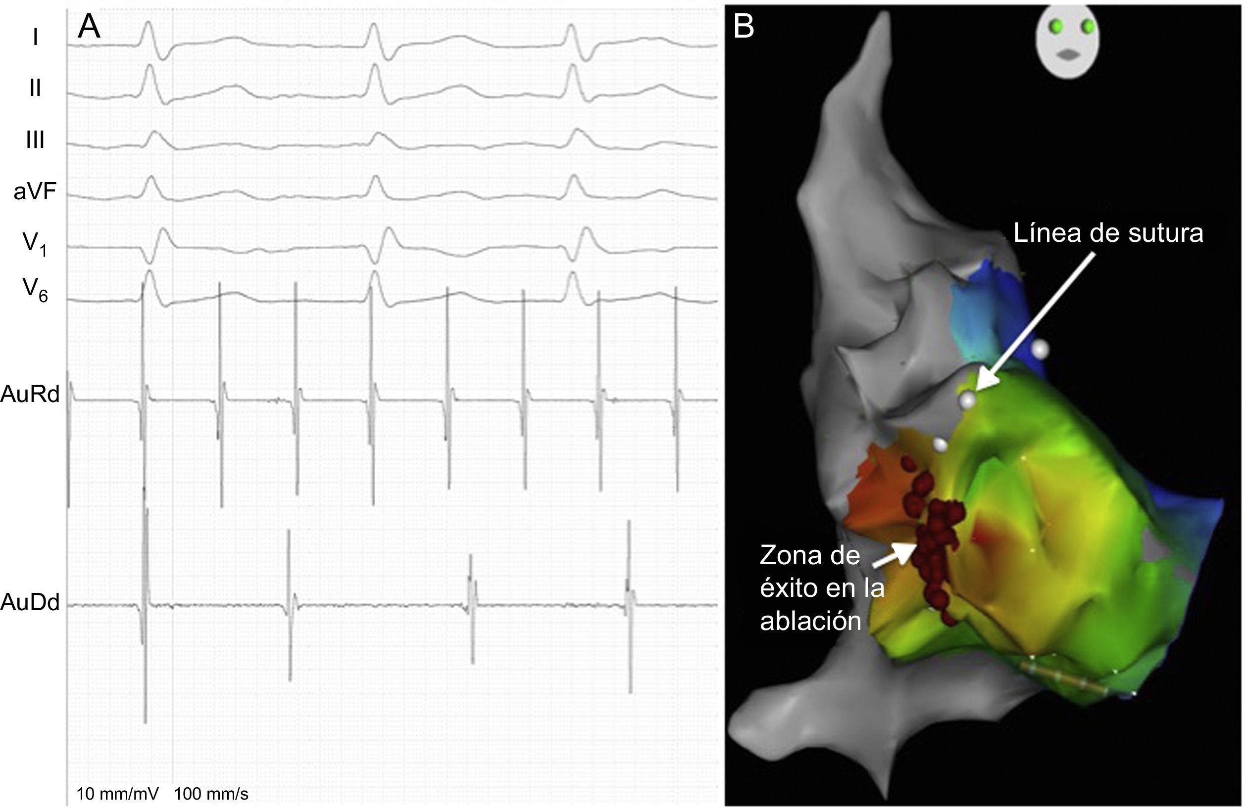 Aleteo auricular atípico y ablación de la conducción transauricular ...