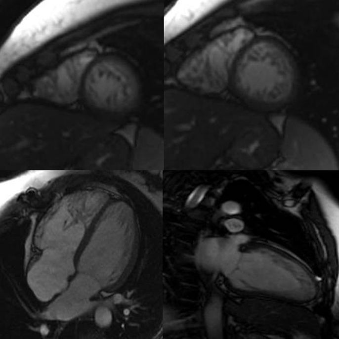 Solapamiento de miocardiopatía arritmogénica y espongiforme con ...