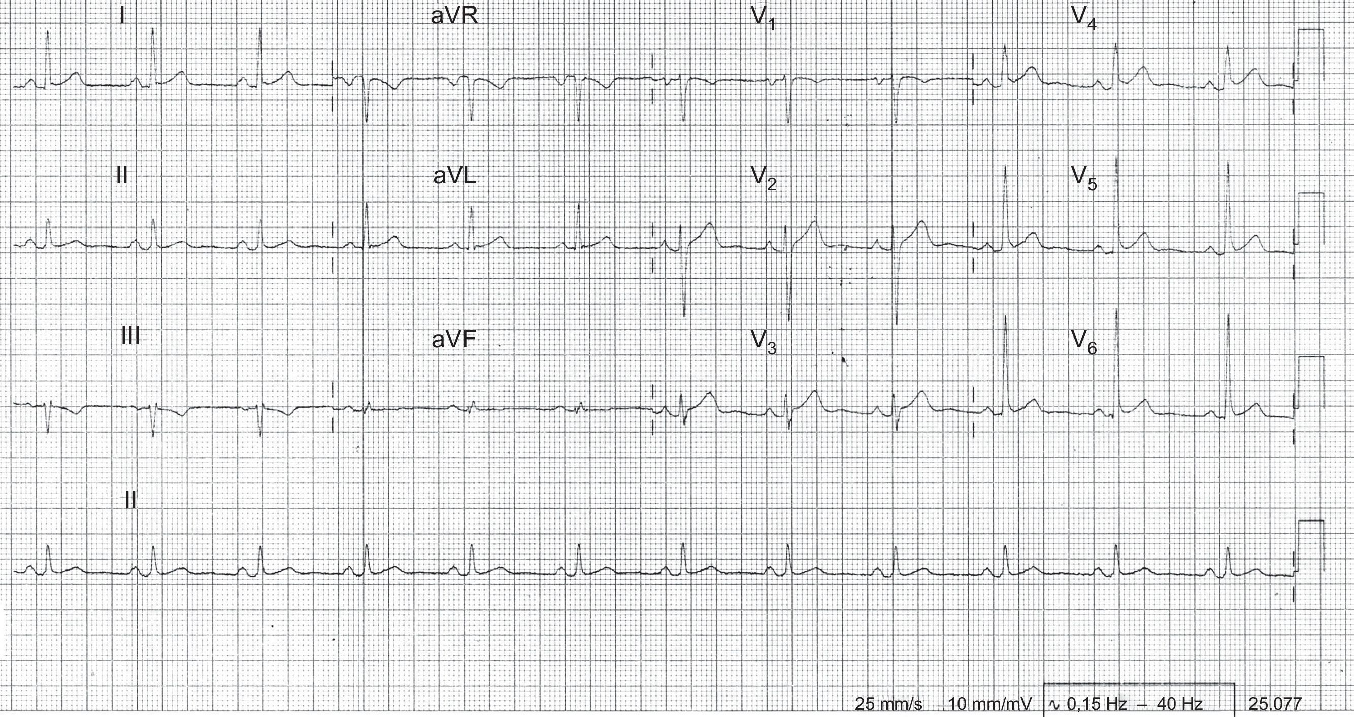 Pericarditis recurrente como presentación en enfermedad de Still del ...