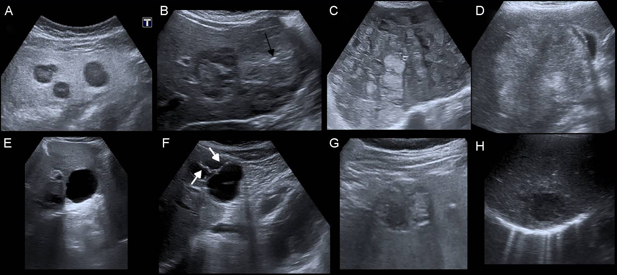 Hígado y enfermedad cardiovascular: lo que el cardiólogo debería ...