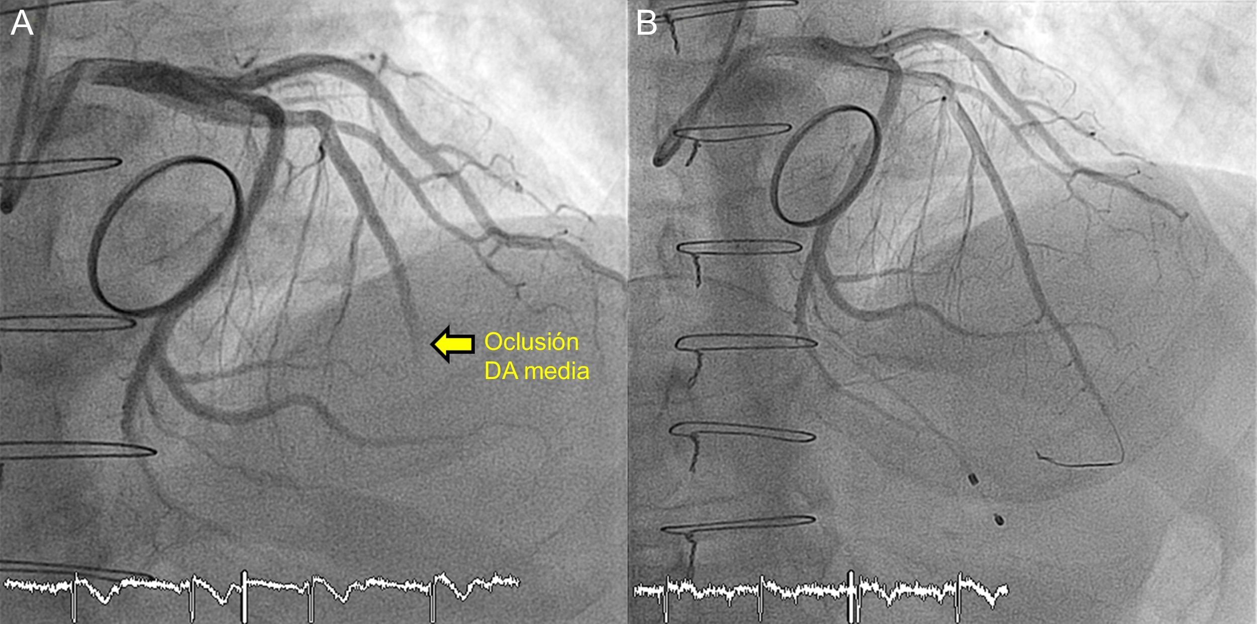 Síndrome coronario agudo por embolia séptica secundaria a endocarditis ...