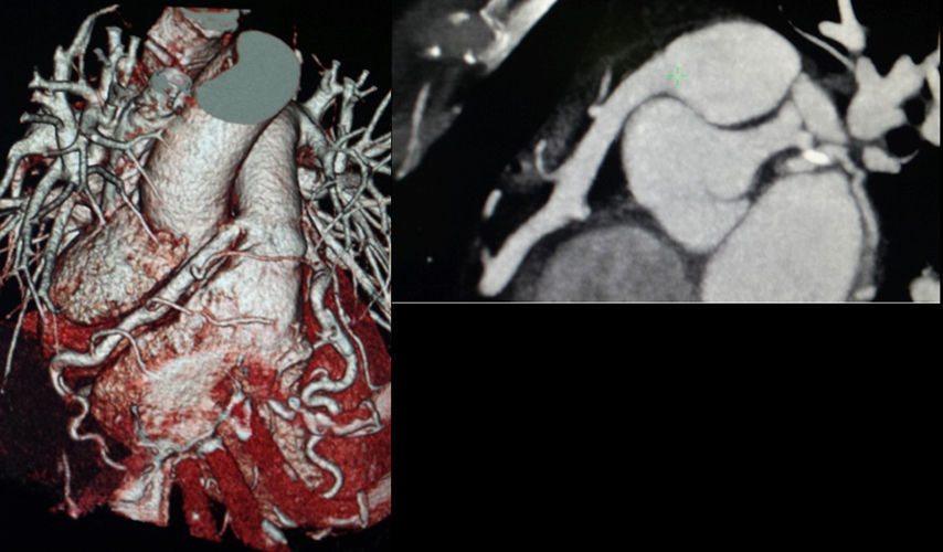 Síndrome de ARCAPA en la edad adulta - Revista Española de Cardiología ...