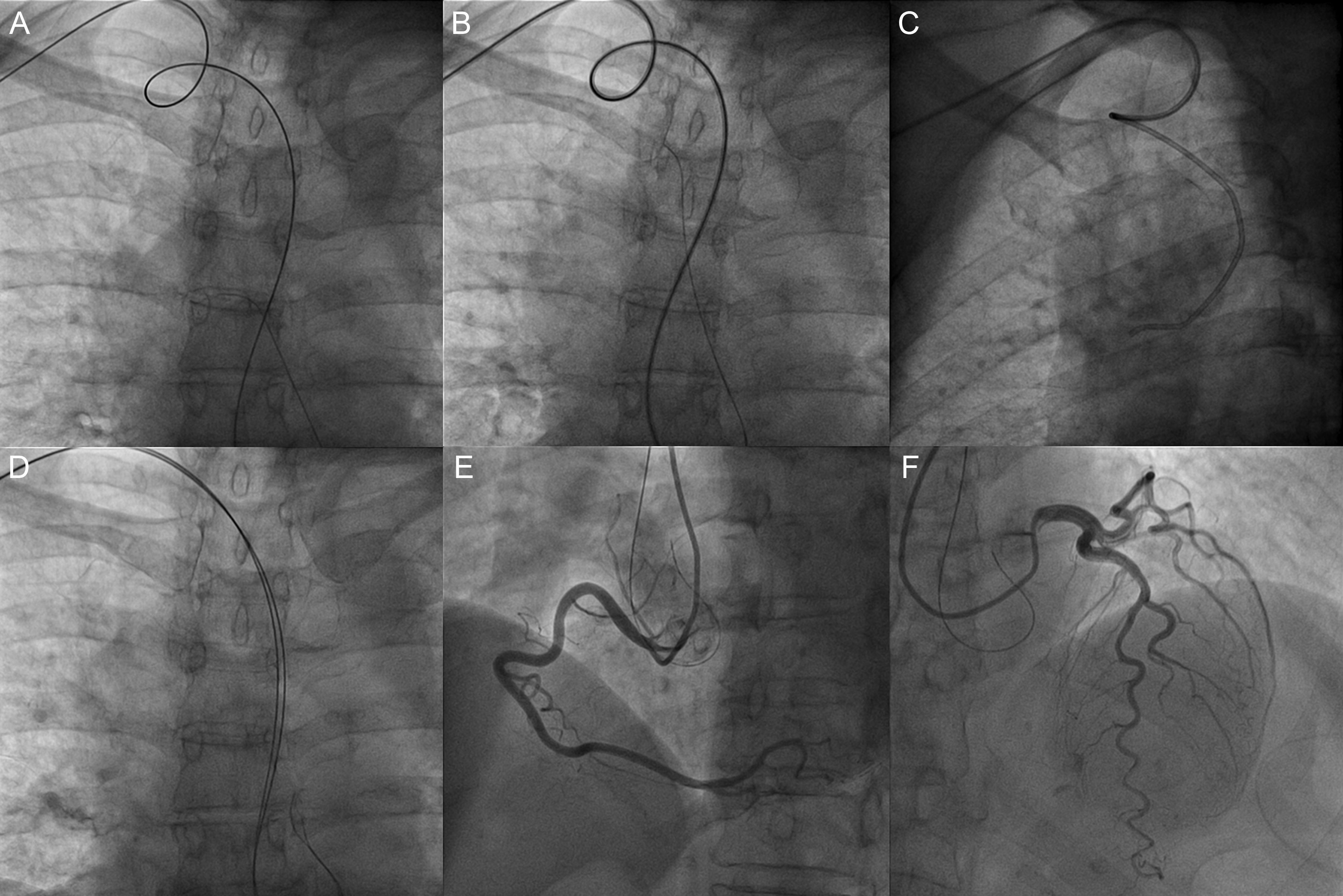 Papel de una guía paralela en tortuosidades y bucles de las arterias ...