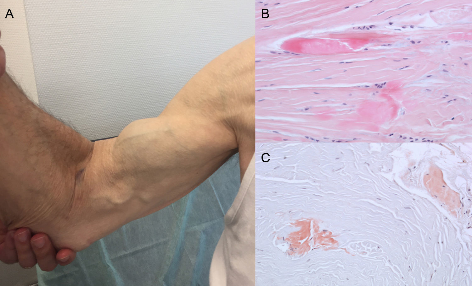 Diagnóstico y tratamiento de la amiloidosis cardiaca por transtiretina ...