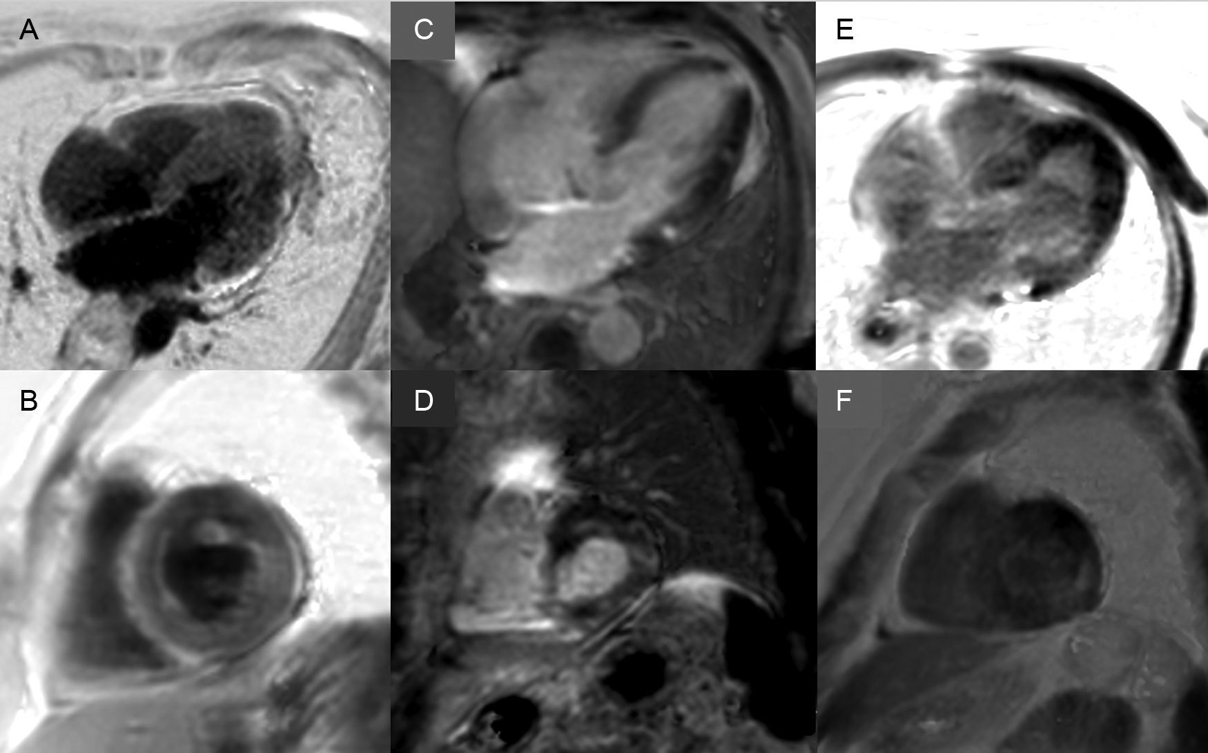 Diagnóstico y tratamiento de la amiloidosis cardiaca por transtiretina ...