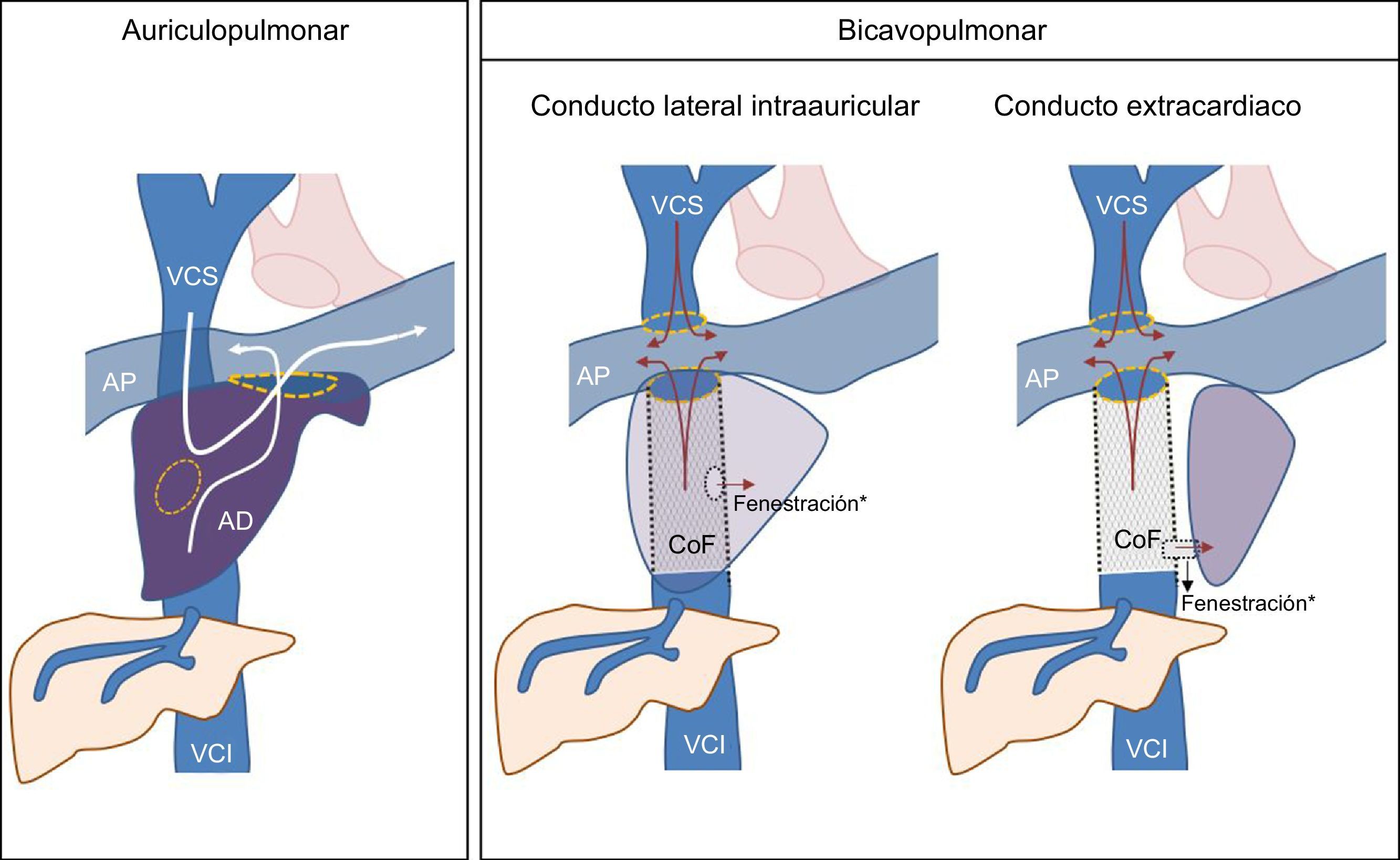 Enfermedad hepática crónica asociada con cirugía de Fontan | Revista ...
