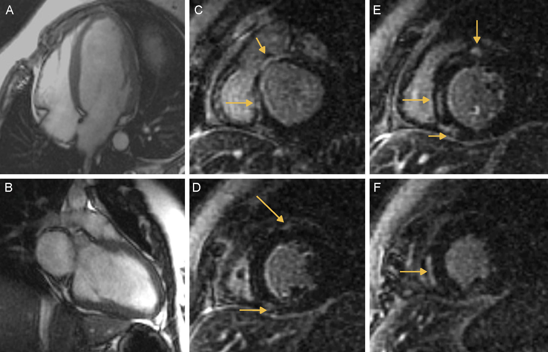 Síndrome de Alström: una rara causa de miocardiopatía | Revista ...