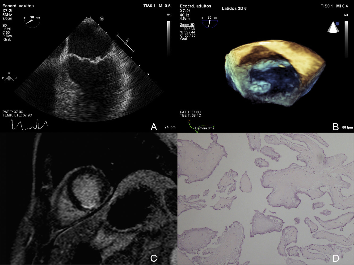 Fibroelastoma papilar recurrente. ¿Es realmente un tumor benigno ...