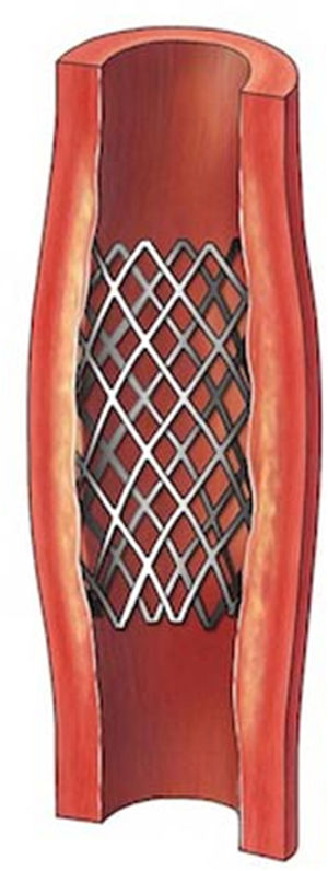Stent | Revista Española de Cardiología