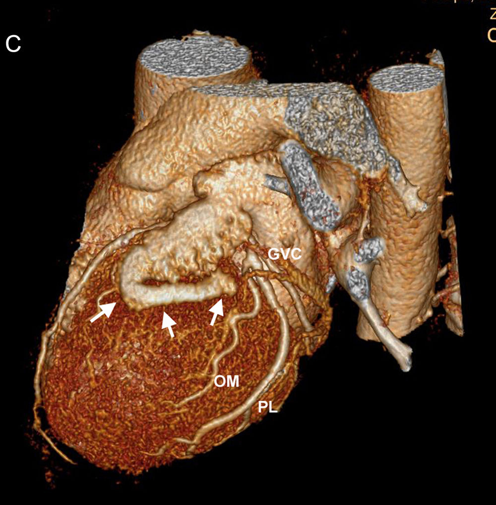 Fístula congénita de orejuela izquierda - Revista Española de Cardiología