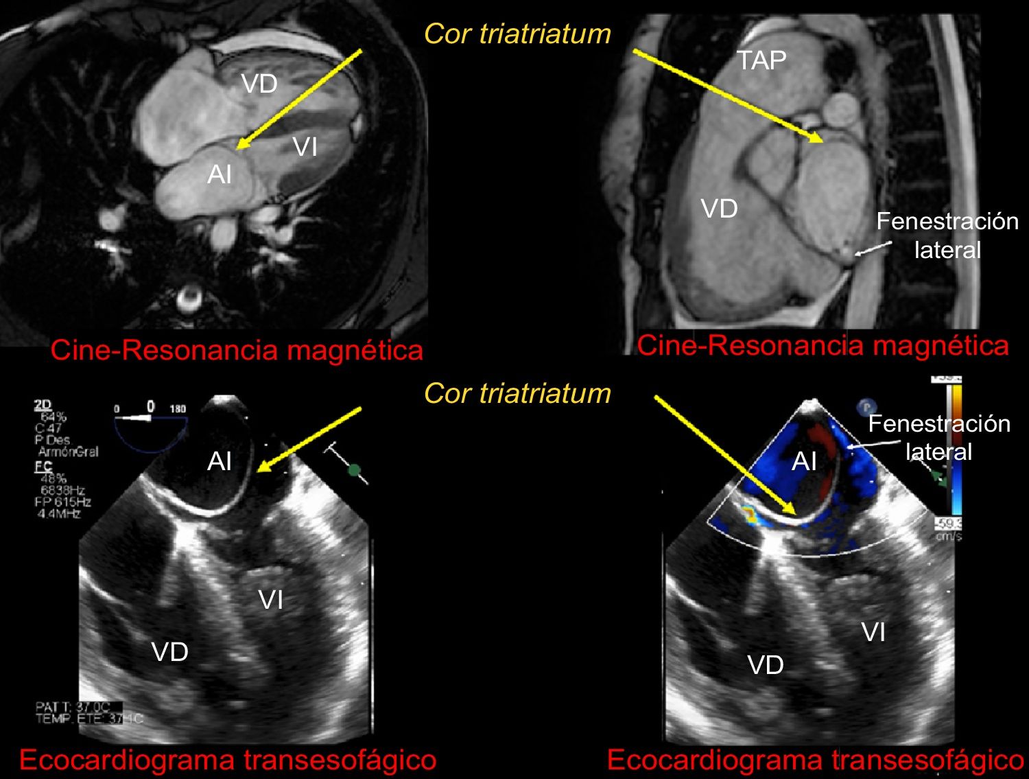 Drenaje venoso pulmonar anómalo con cor triatriatum - Revista Española ...