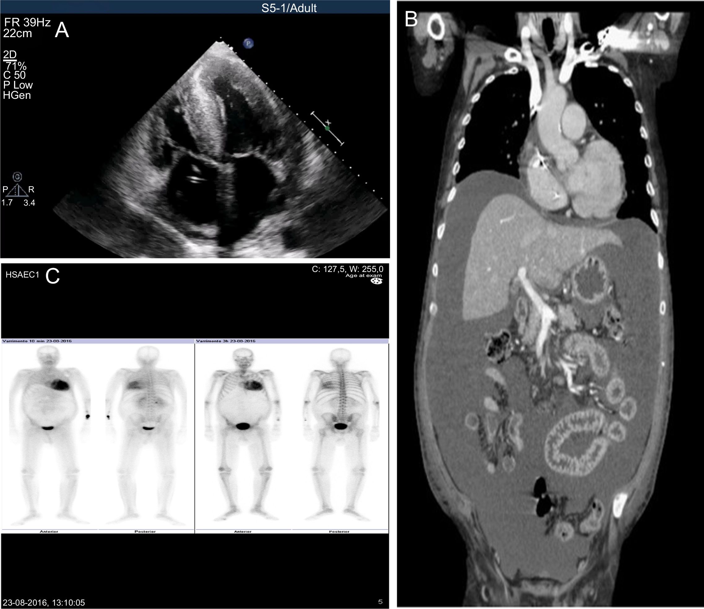 Polineuropatía amiloidótica familiar Val30Met, insuficiencia cardiaca y ...