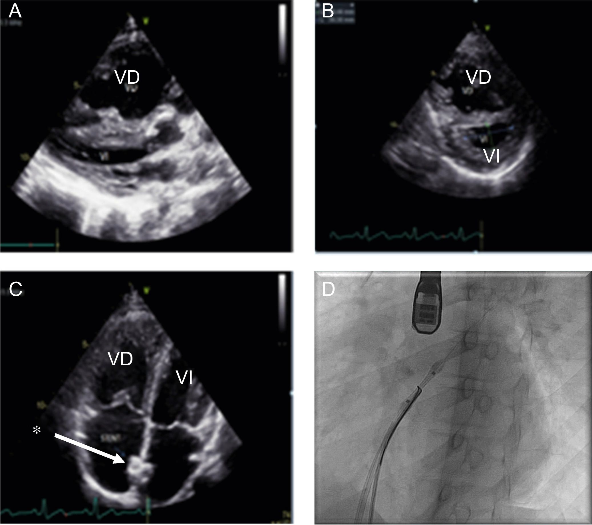 Septostomía auricular en niños con hipertensión pulmonar | Revista ...