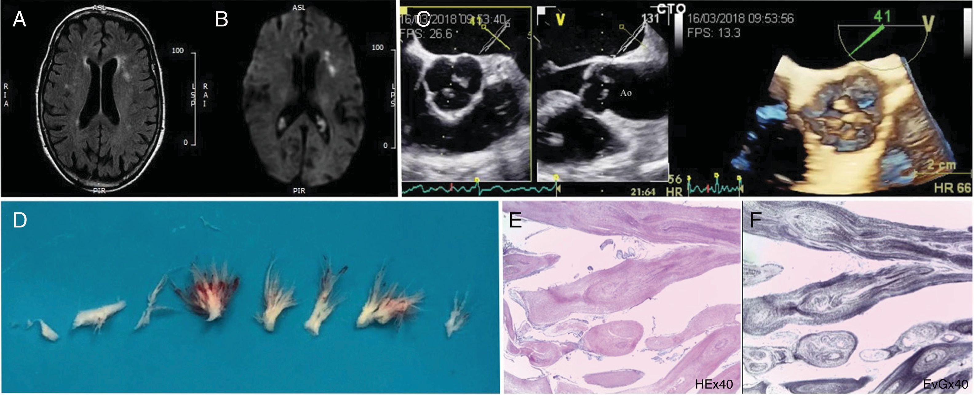 Fibroelastoma papilar aórtico sintomático: una lesión multifocal ...