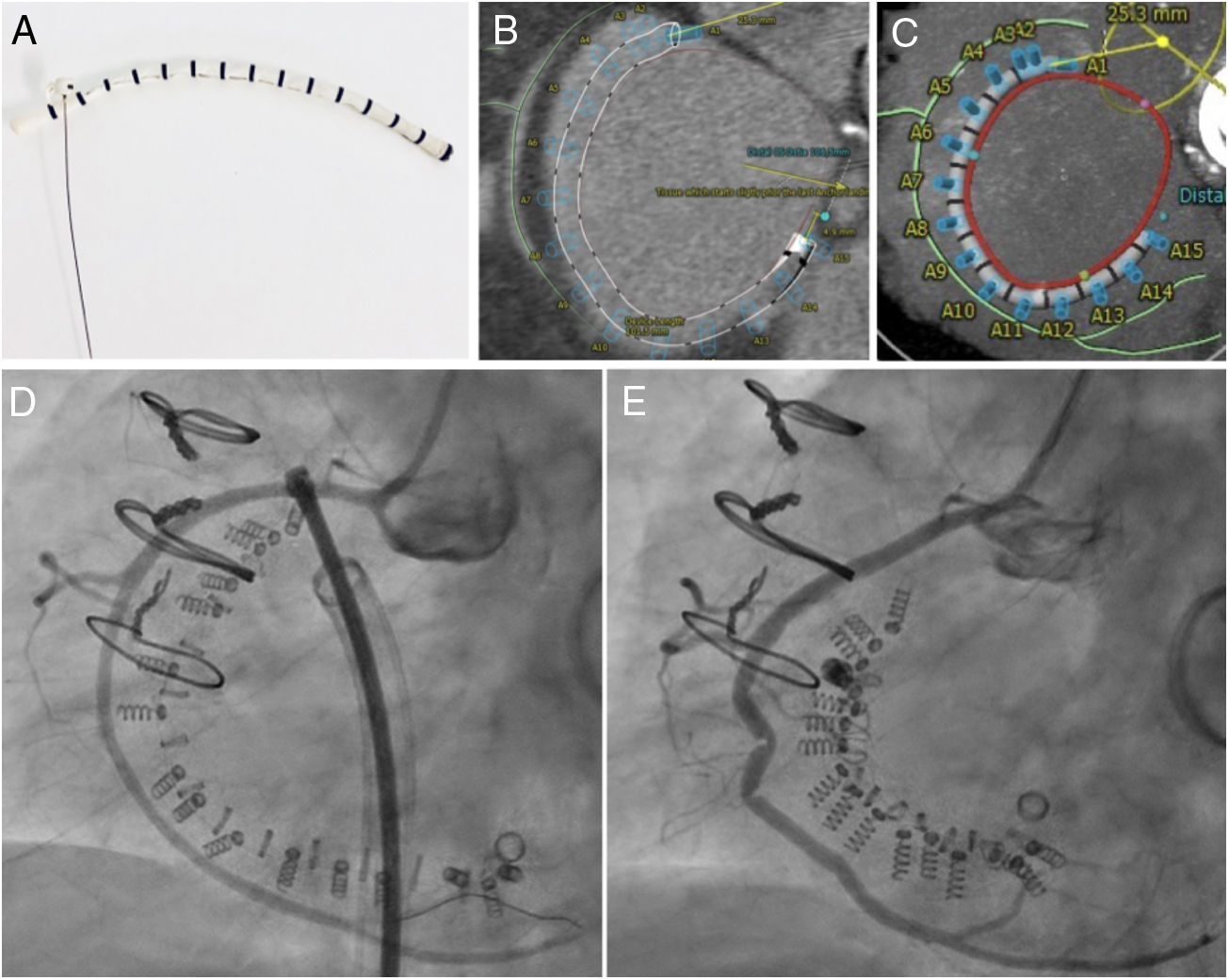 Anuloplastia tricuspídea percutánea con dispositivo Cardioband para el ...