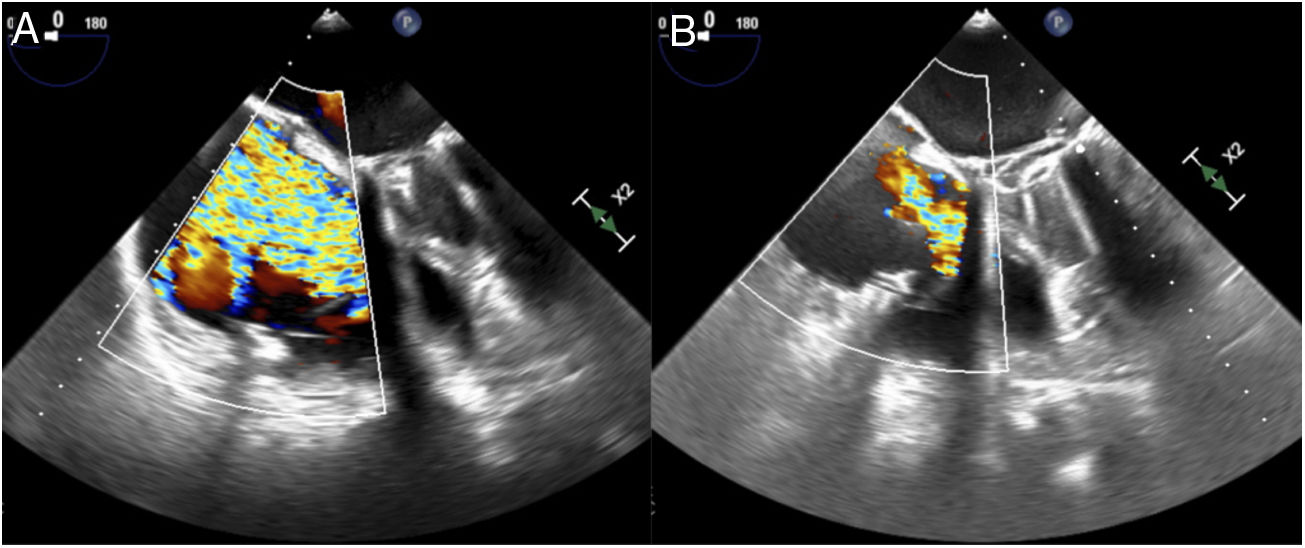 Anuloplastia tricuspídea percutánea con dispositivo Cardioband para el ...