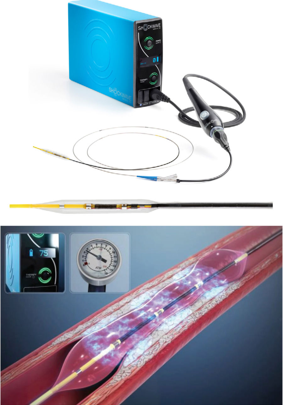 Litoplastia coronaria en lesiones calcificadas: registro multicéntrico ...