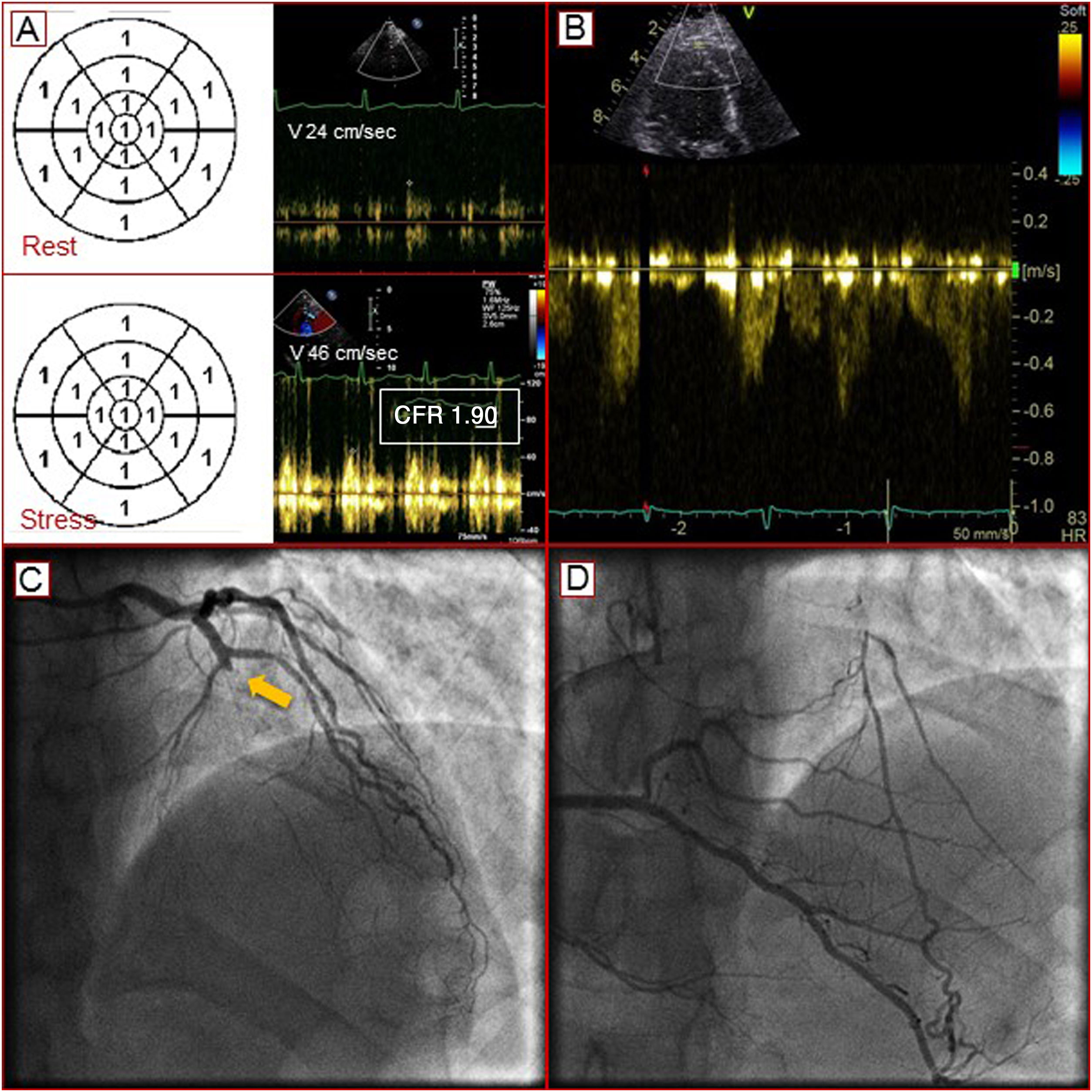 Valor diagnóstico de la reserva de flujo coronario mediante eco ...