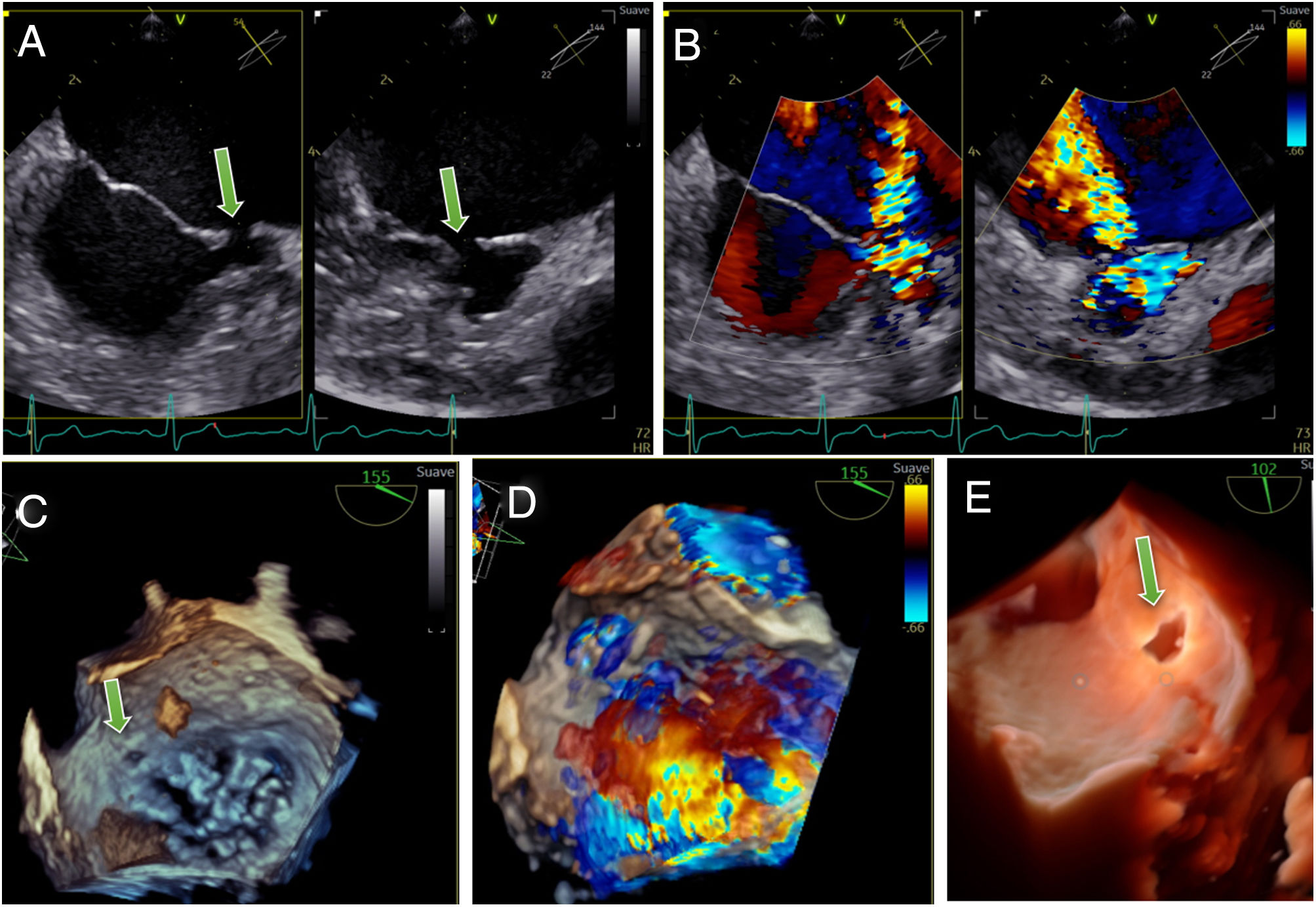 Fístula paravalvular mitral cerrada de manera percutánea con oclusor ...