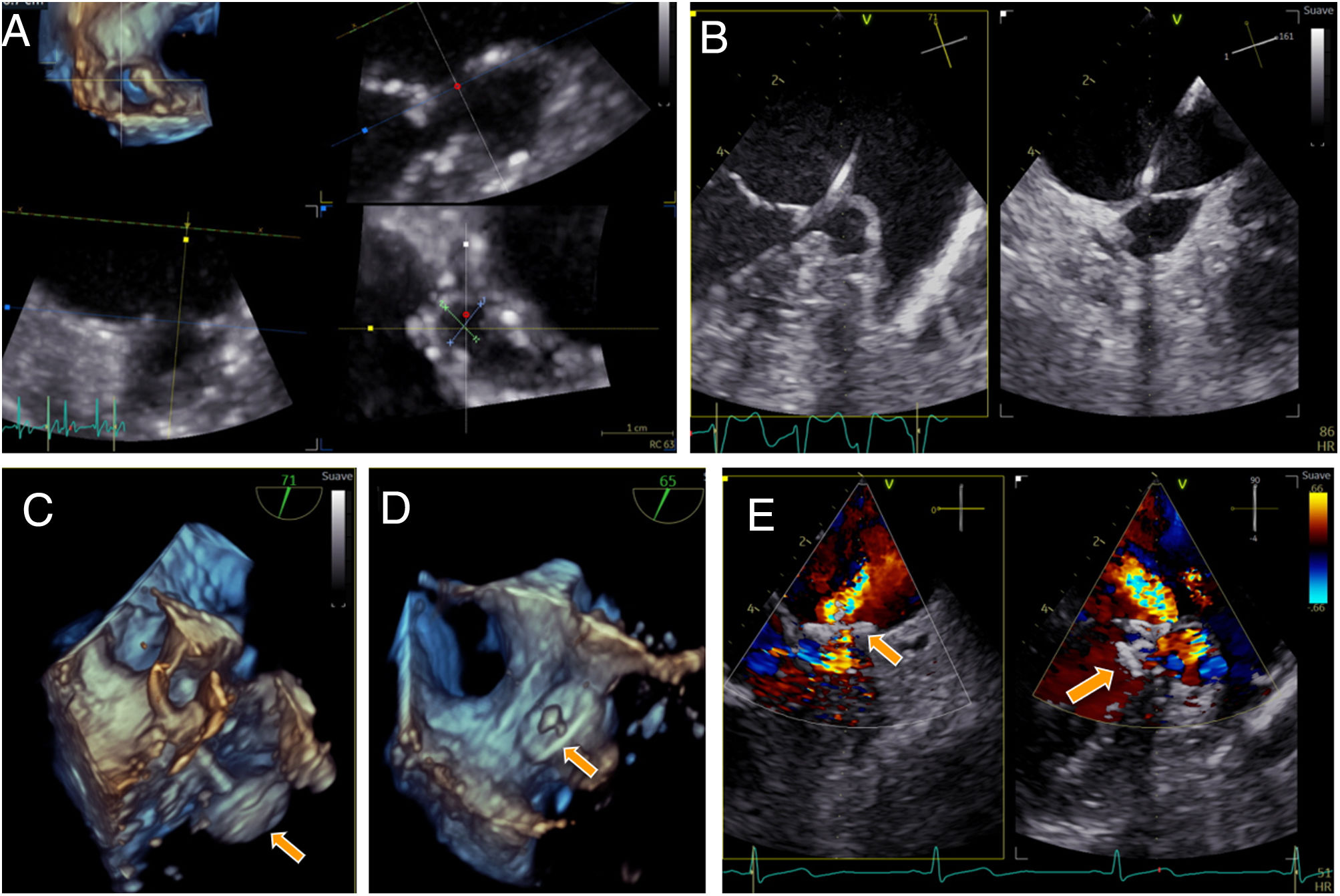 Fístula paravalvular mitral cerrada de manera percutánea con oclusor ...