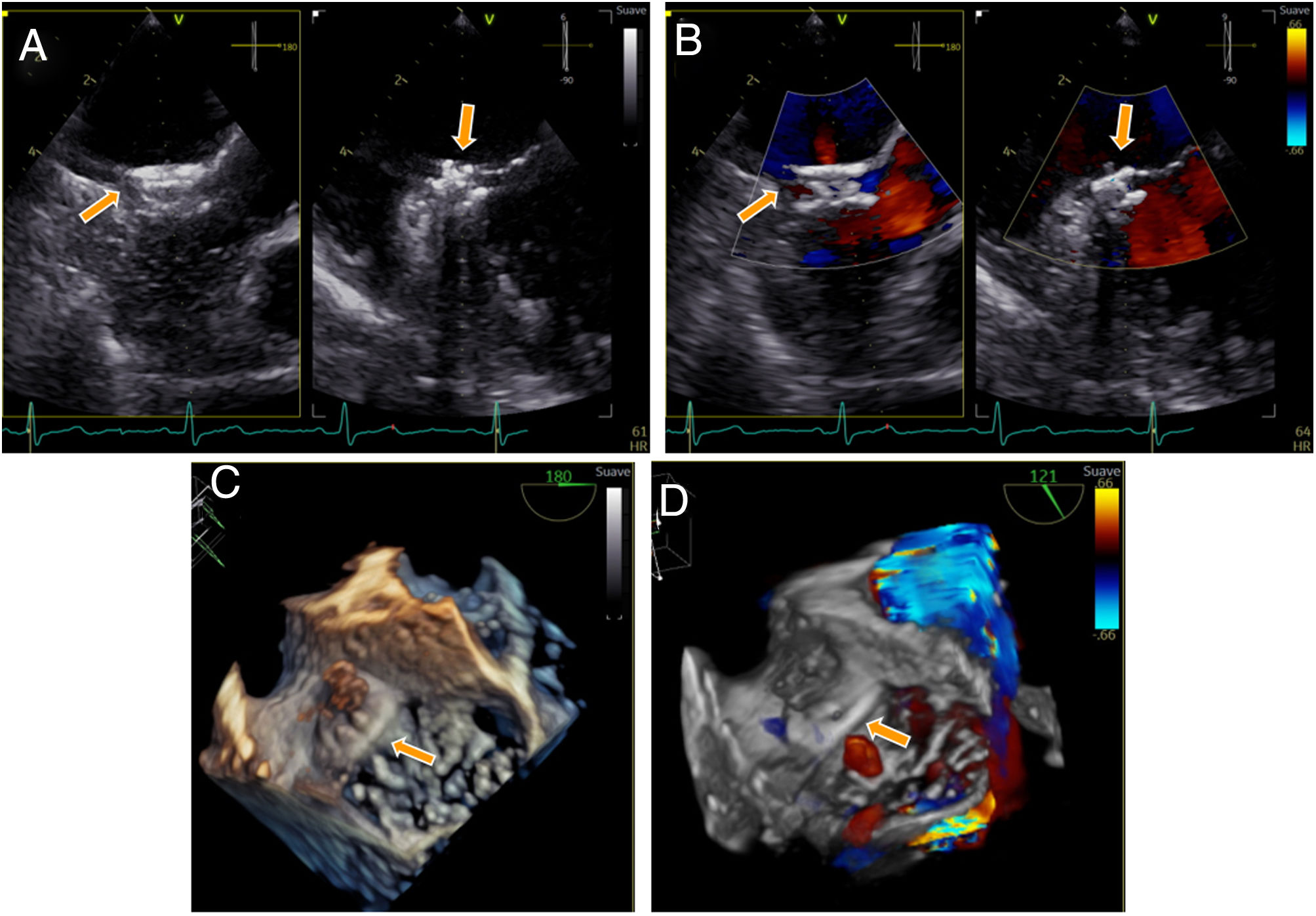 Fístula paravalvular mitral cerrada de manera percutánea con oclusor ...