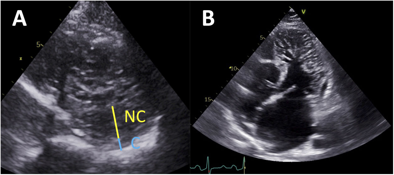 Miocardio no compactado: ¿una enfermedad o un rasgo fenotípico ...