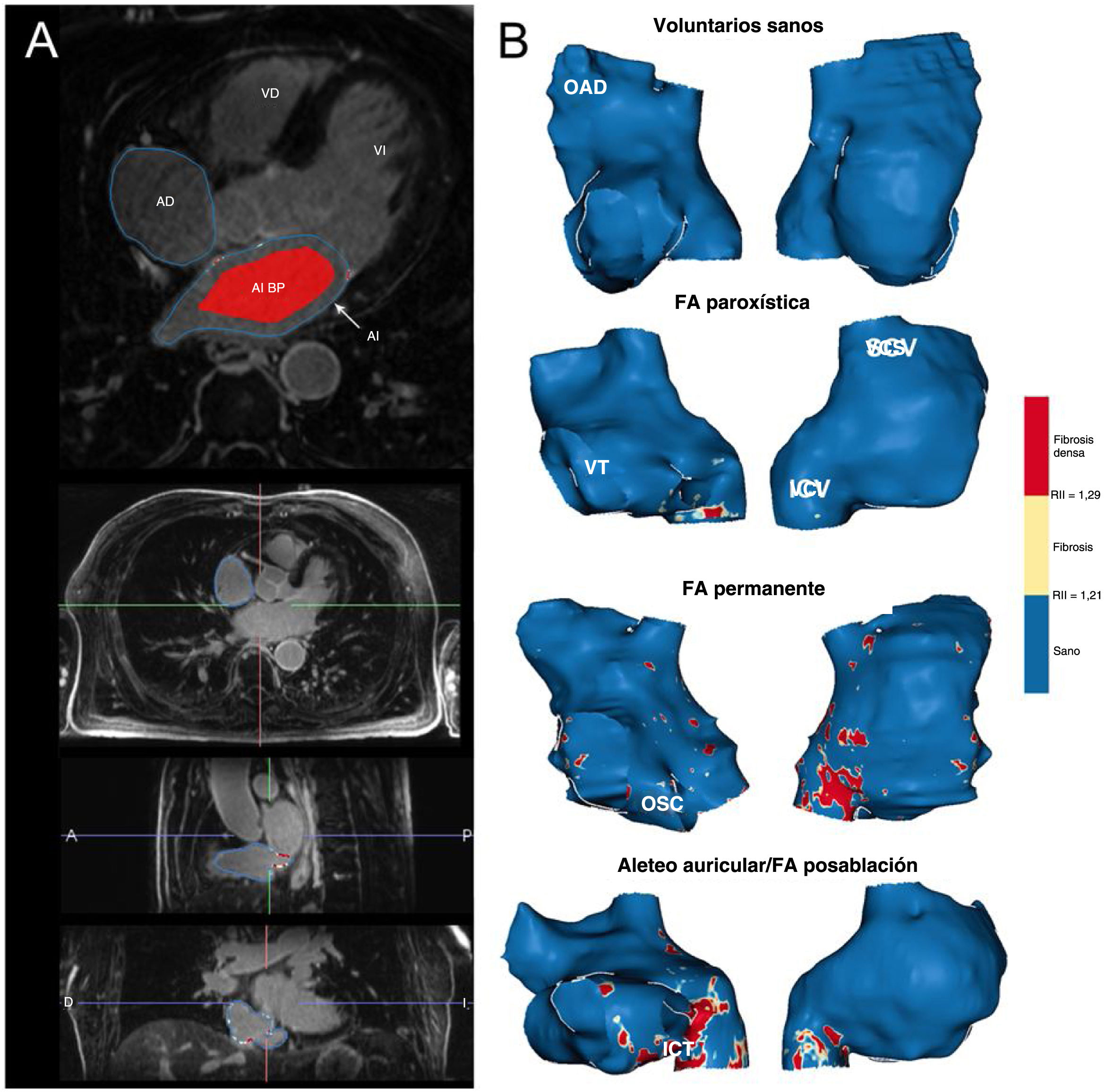 Cuantificación de la fibrosis auricular derecha mediante resonancia ...