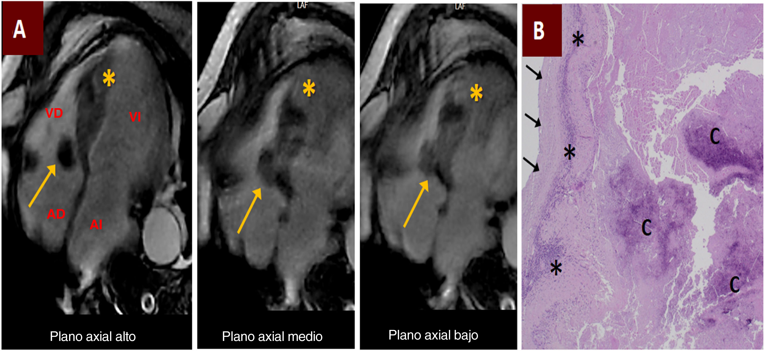 Imagen multimodal en la necrosis caseosa del anillo tricuspídeo ...