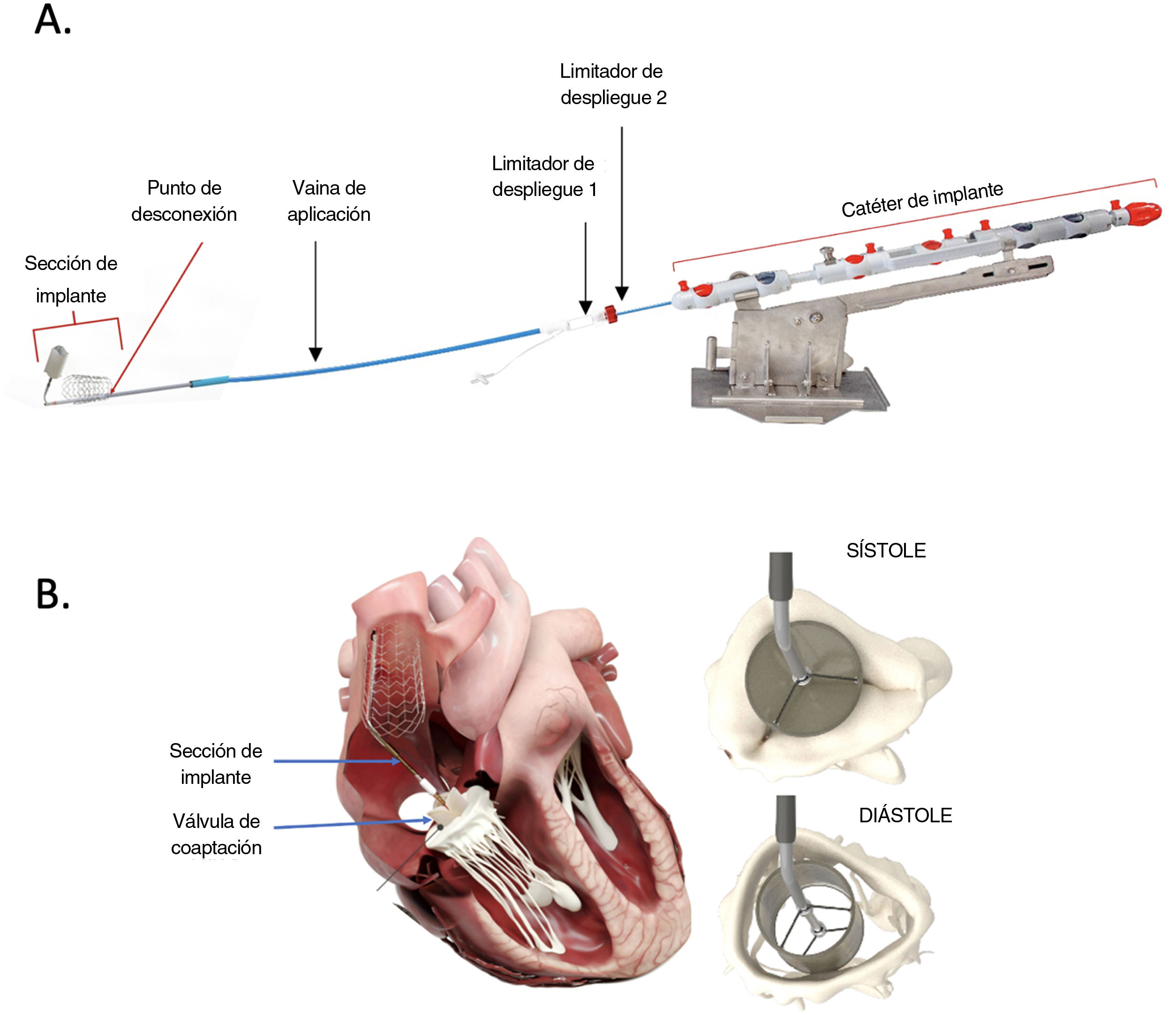 Sistema ortotópico percutáneo de coaptación de la válvula tricúspide ...