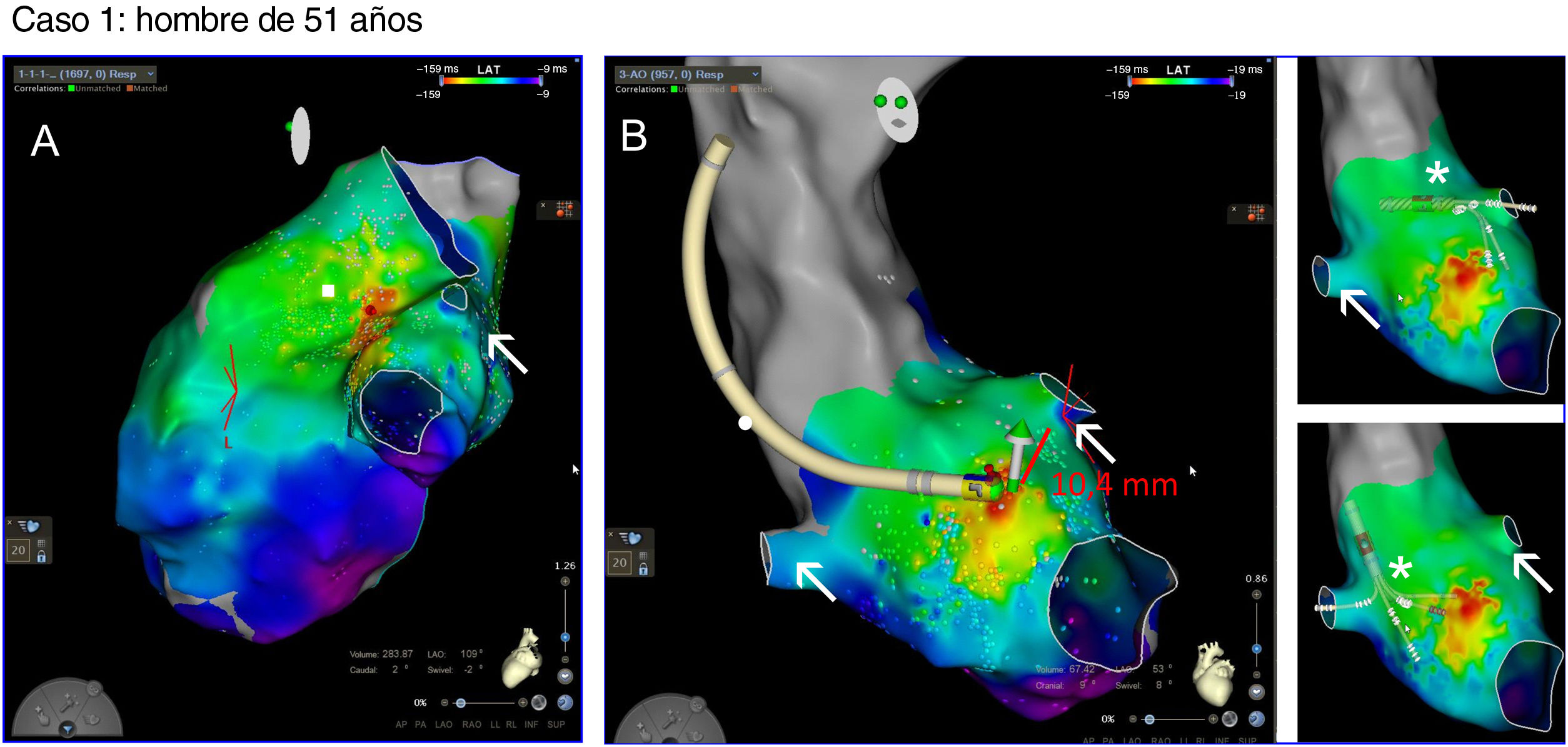 Localización de los ostium coronarios con el PentaRay | Revista ...