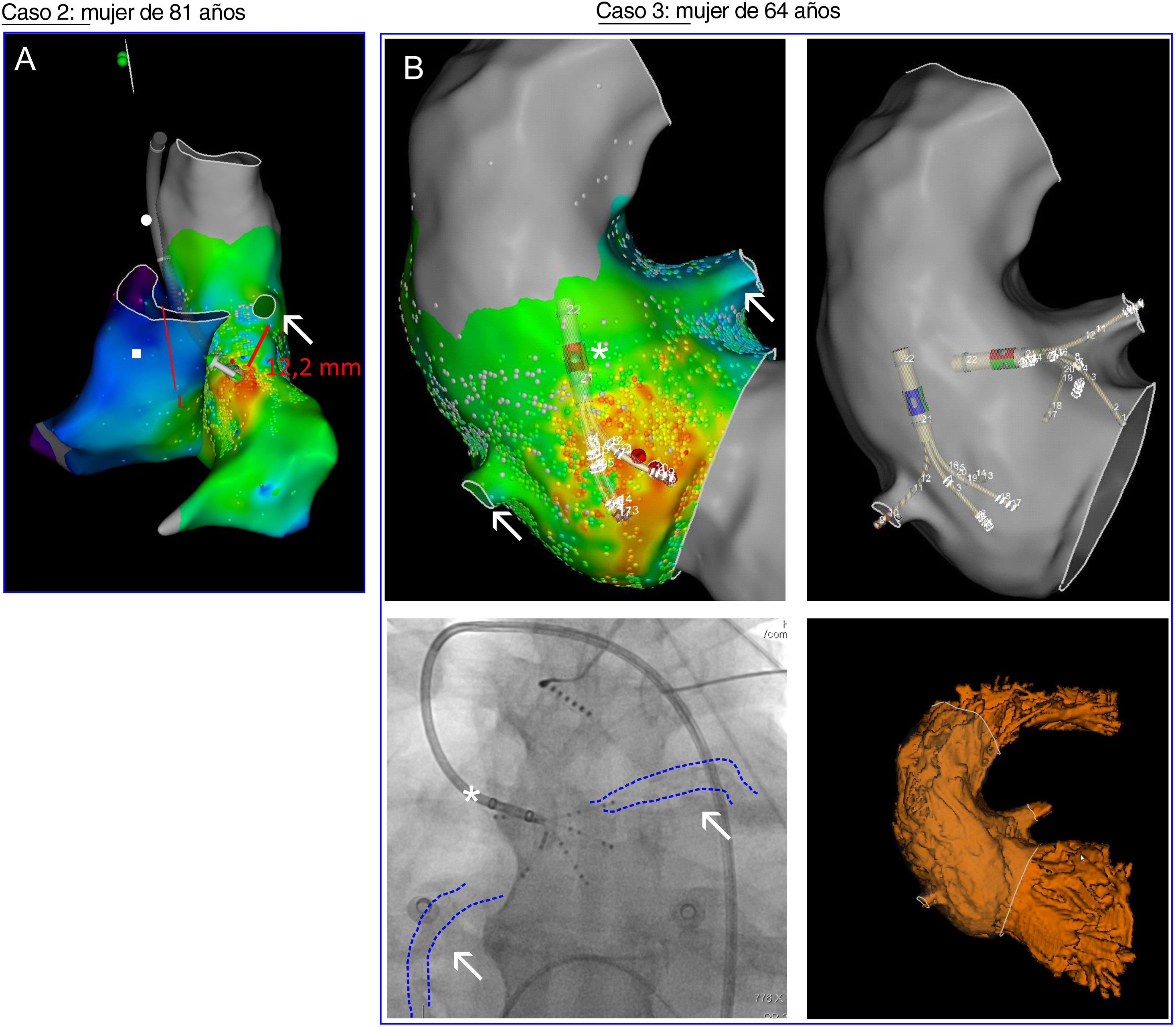 Localización de los ostium coronarios con el PentaRay | Revista ...