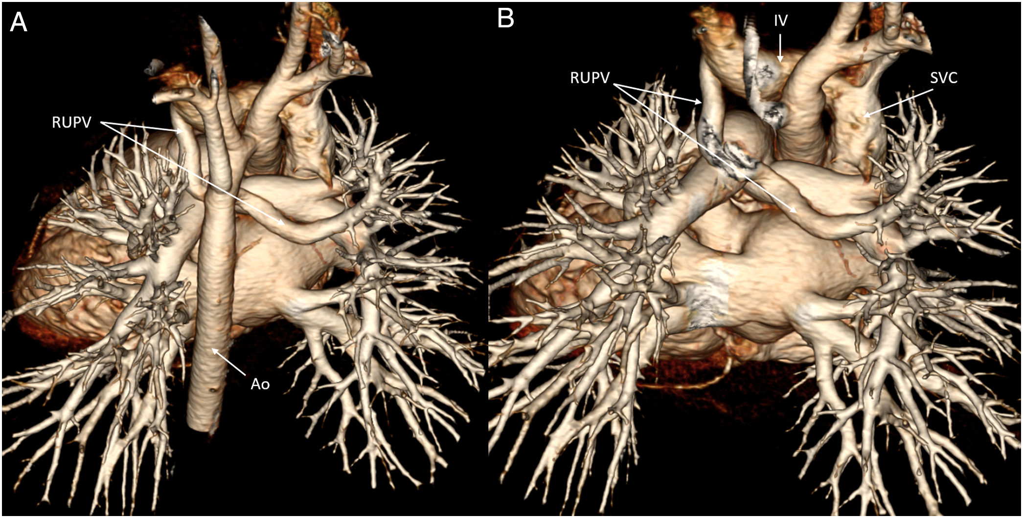 Vena pulmonar superior derecha que cruza la línea media | Revista ...