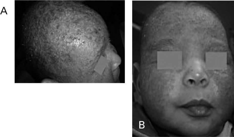 Food allergy in an exclusively breast-fed infant with Hyper-IgE ...
