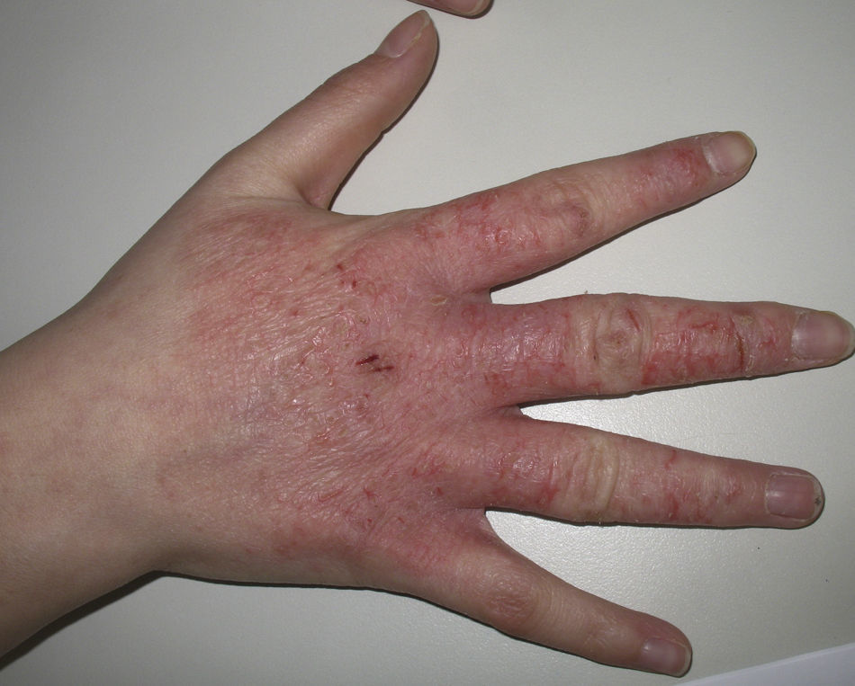 manganese intolerance