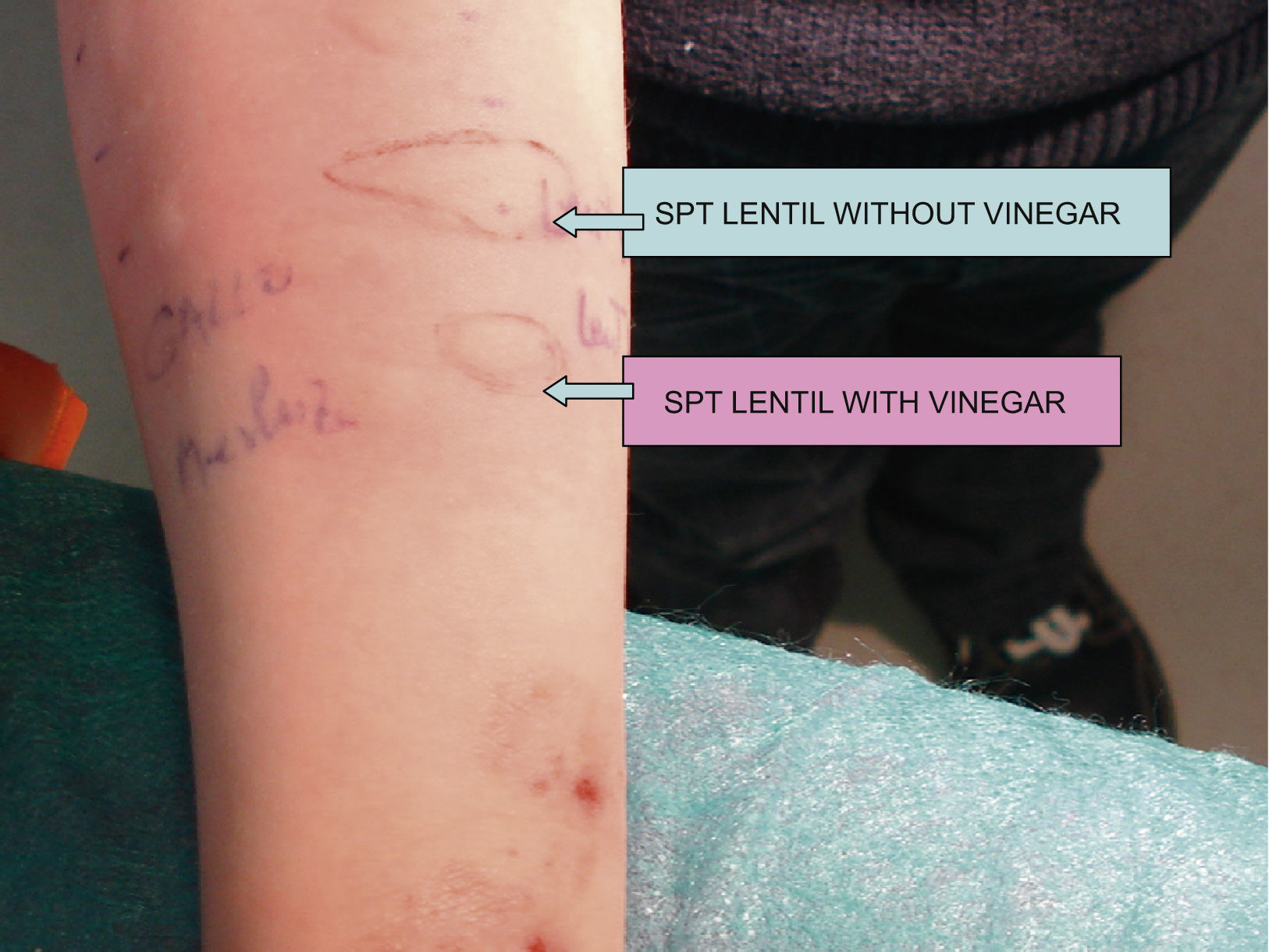 Vinegar decreases allergenic response in lentil and egg food allergy ...